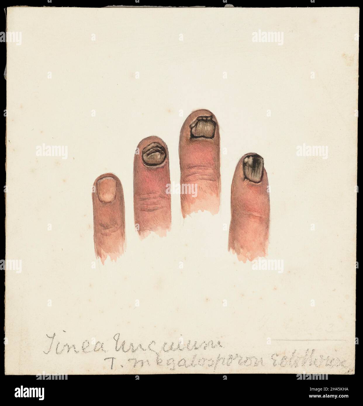Four fingers with diseased nails designated as Tinea unguium ...