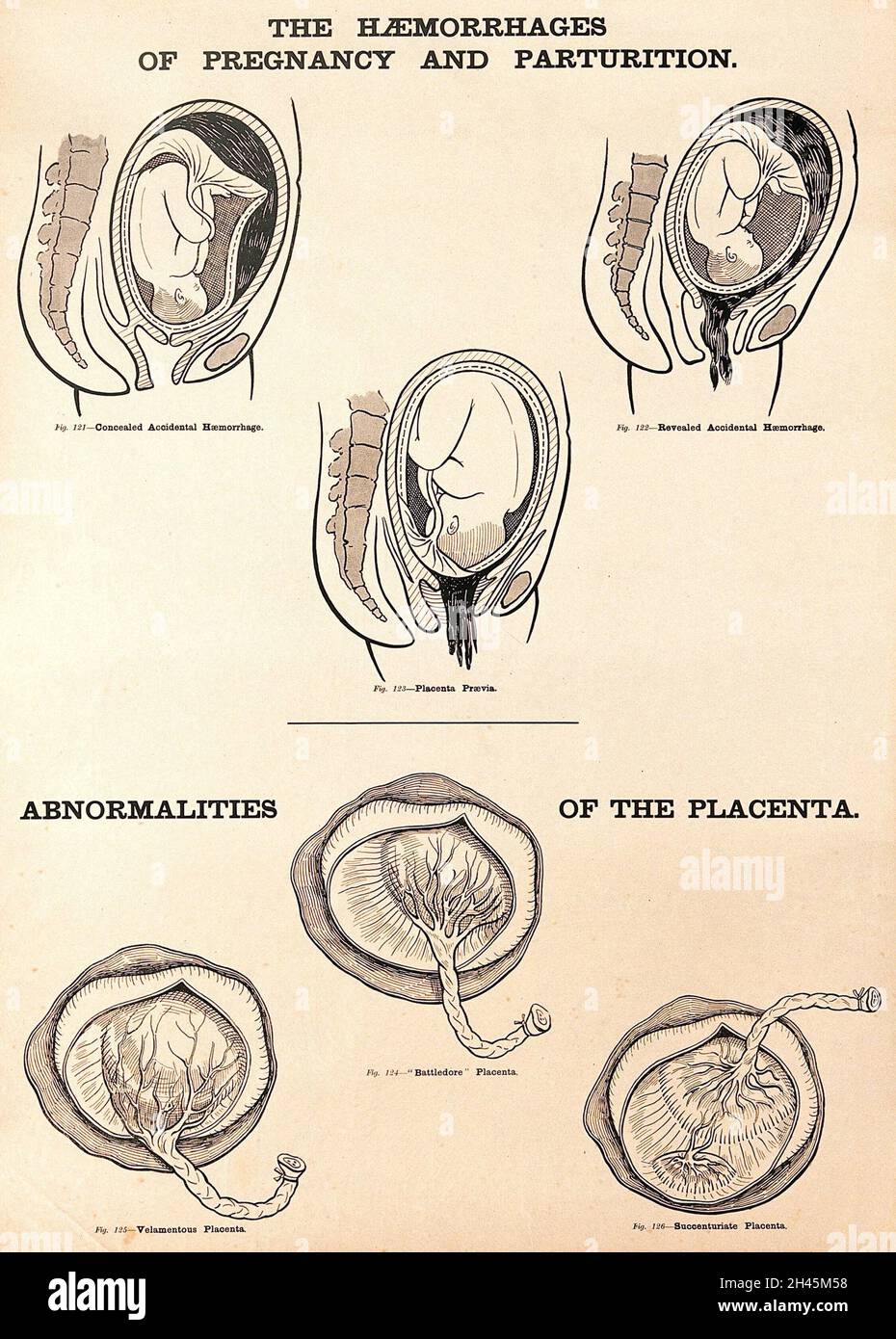 Battledore Placenta