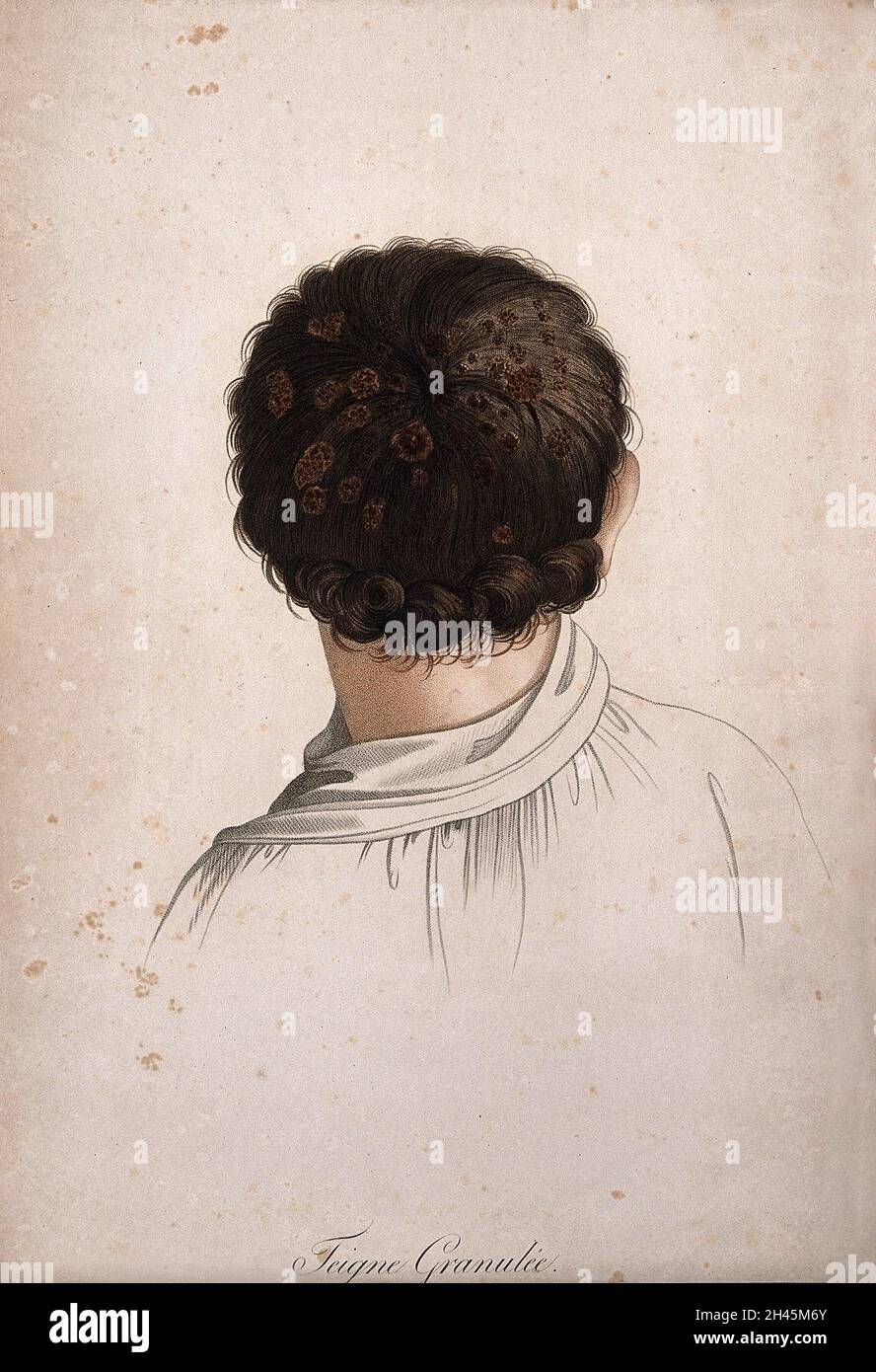 Back of head showing skin disease. Coloured stipple engraving by S ...