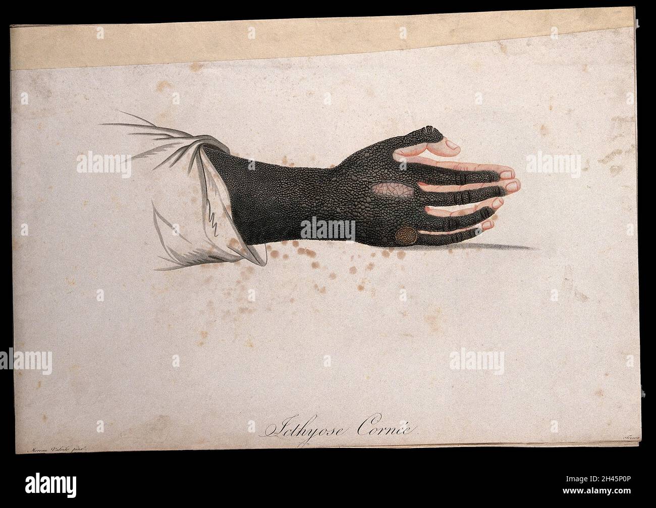 A hand and forearm with a skin disease. Coloured stipple engraving by S ...