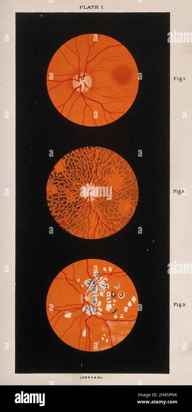 The eye, as seen through a microscope: three figures. Colour lithograph ...