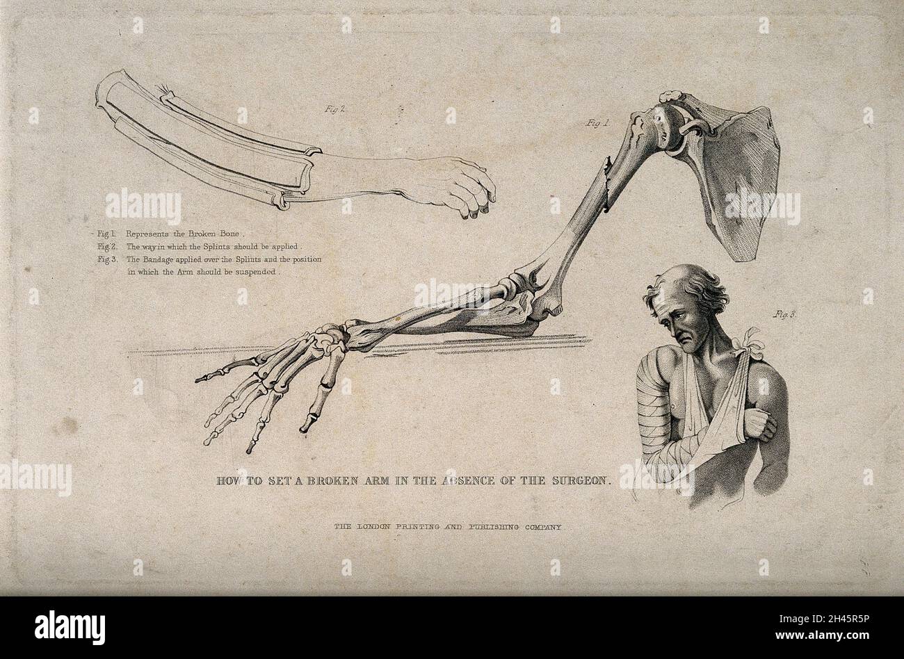 Diagrams illustrating how to set a broken arm. Stipple engraving Stock ...