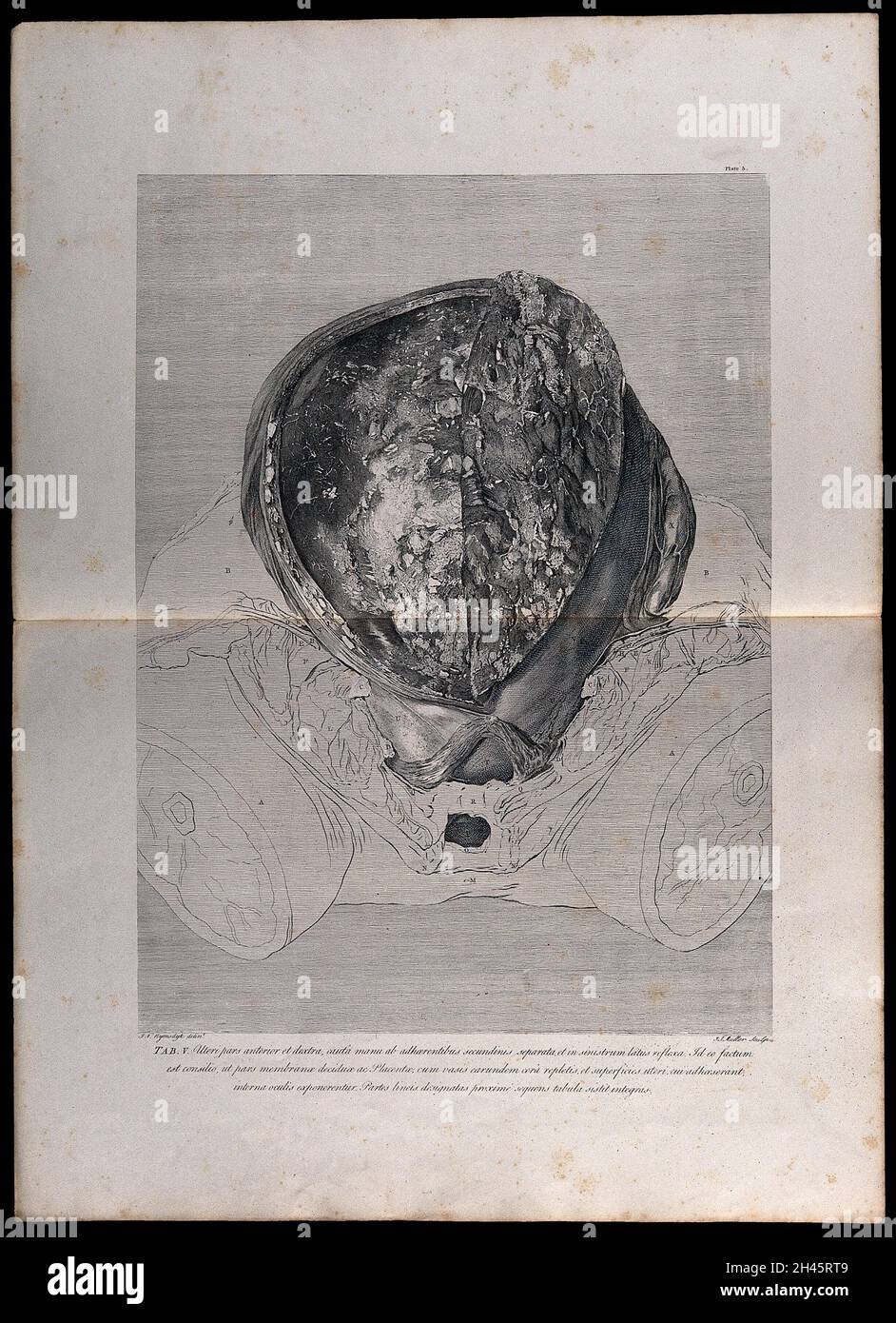 Dissection of the pregnant uterus: initial view of the opened womb ...
