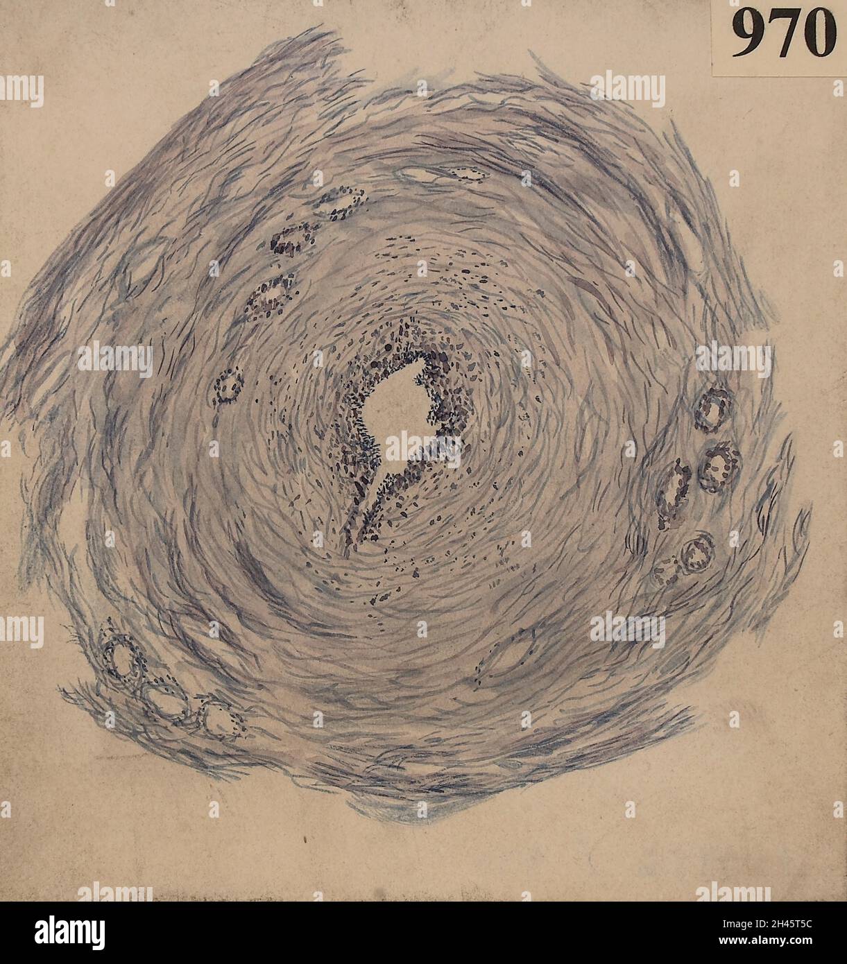 Microscopical appearance of the undistended part of the left fallopian ...