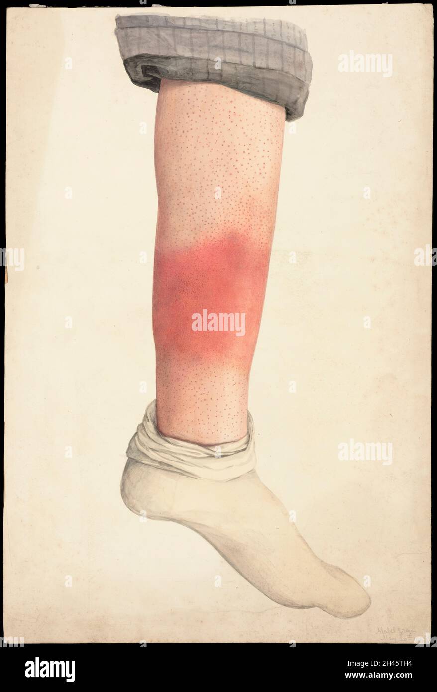 Rash leg hi-res stock photography and images - Alamy