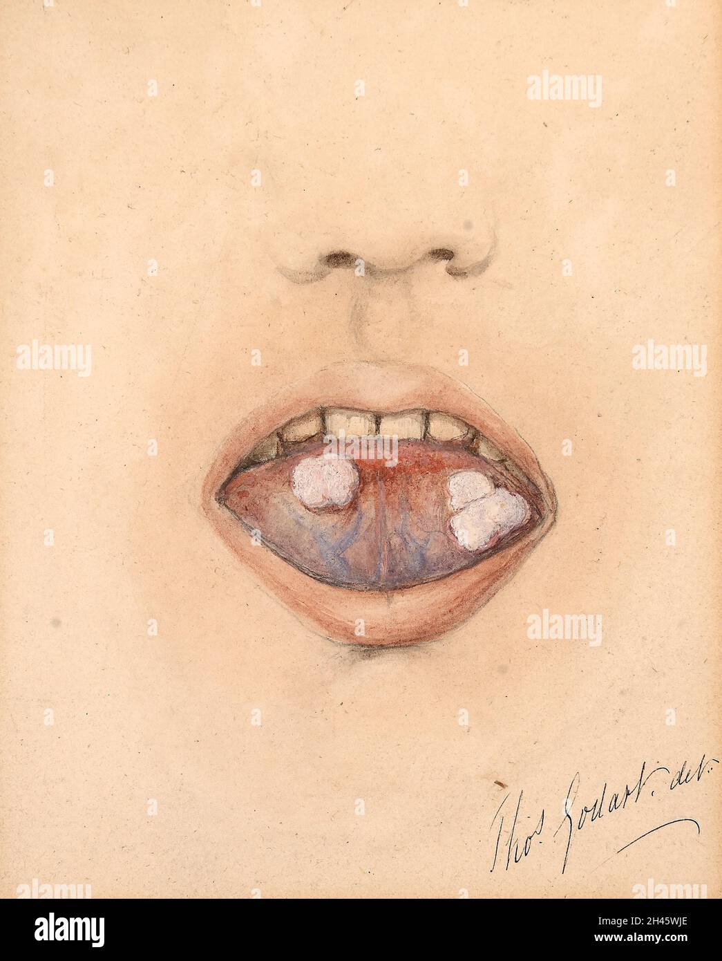 Condylomata on the tongue of a man suffering from secondary syphilis ...