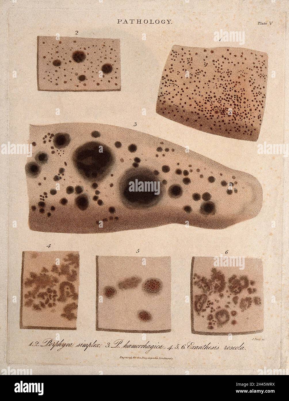 Six patches of skin showing types of skin disease. Coloured stipple ...