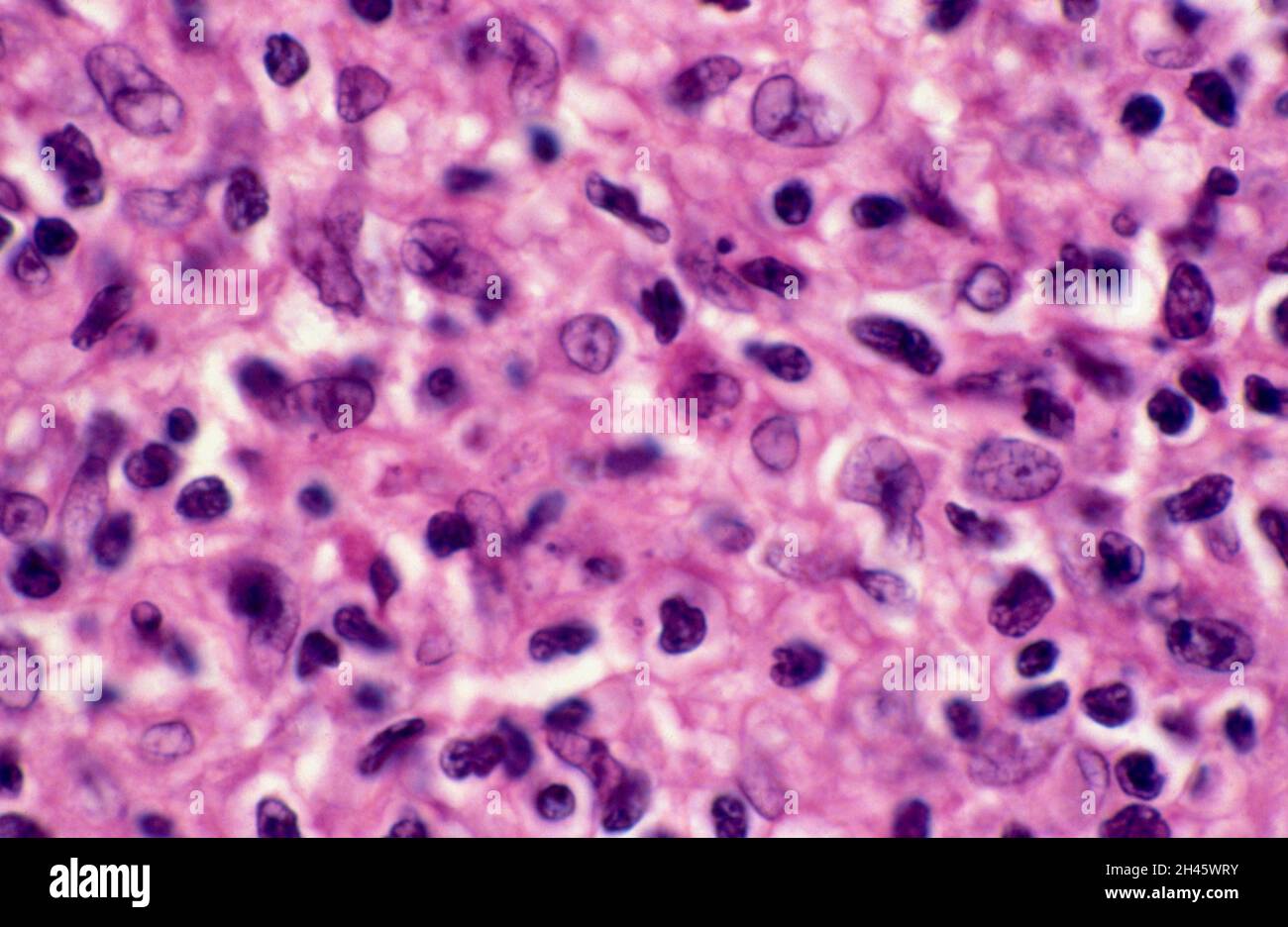 Post kala azar dermal leishmaniasis: skin lesion Stock Photo - Alamy