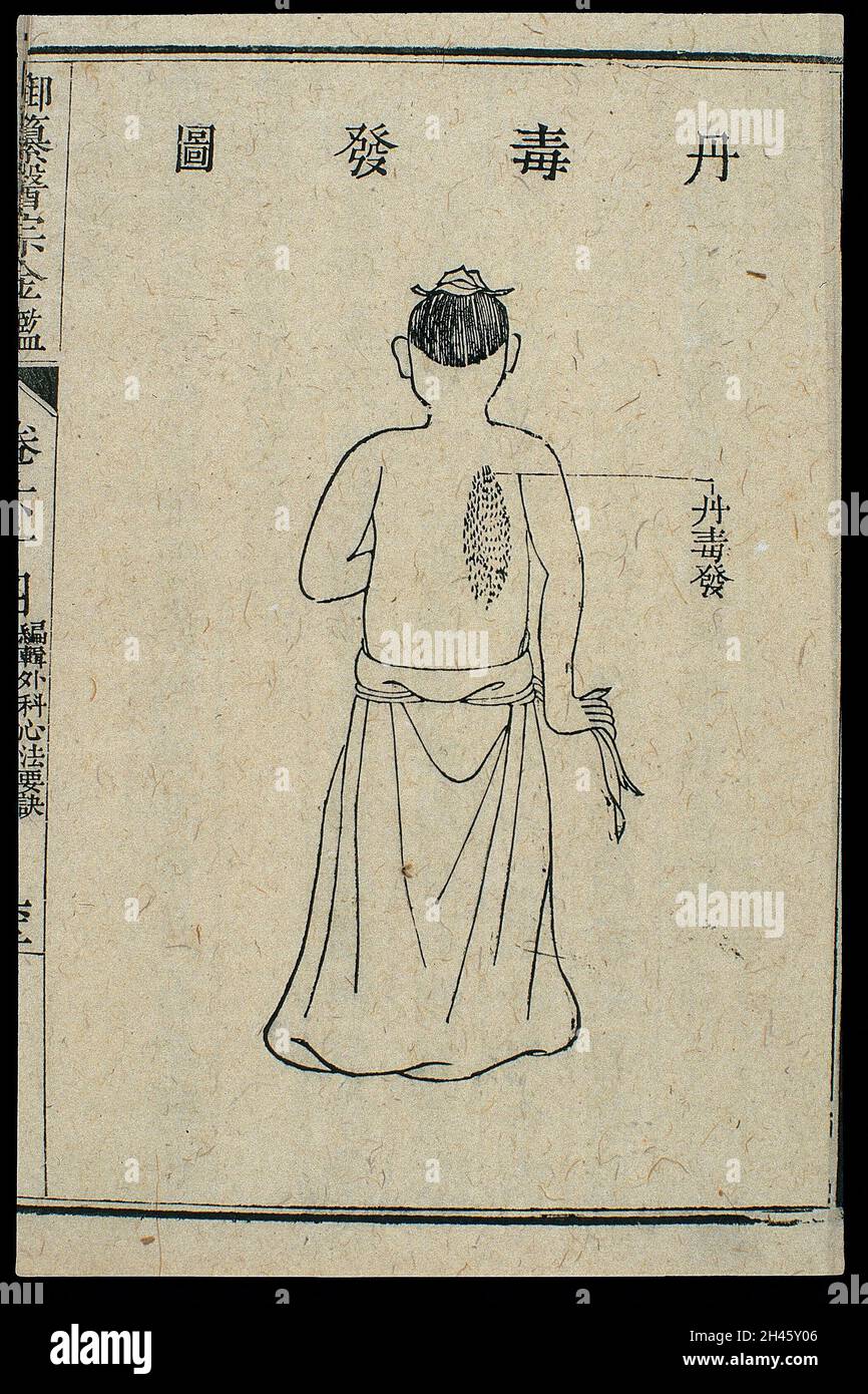 Chinese C18 woodcut: External medicine - Erysipelas Stock Photo - Alamy
