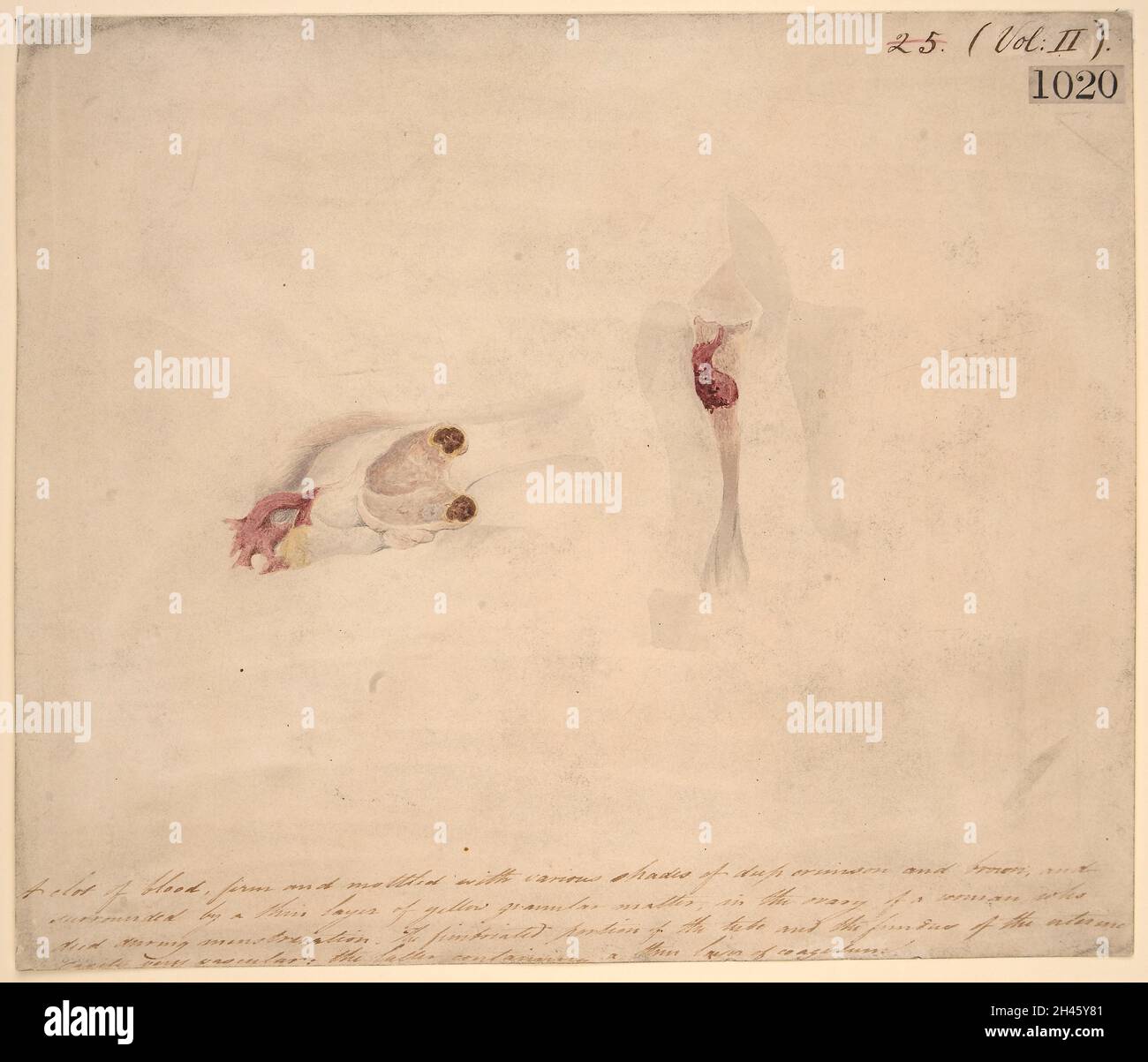 Clot of blood in the ovary from a woman who died during menstruation ...
