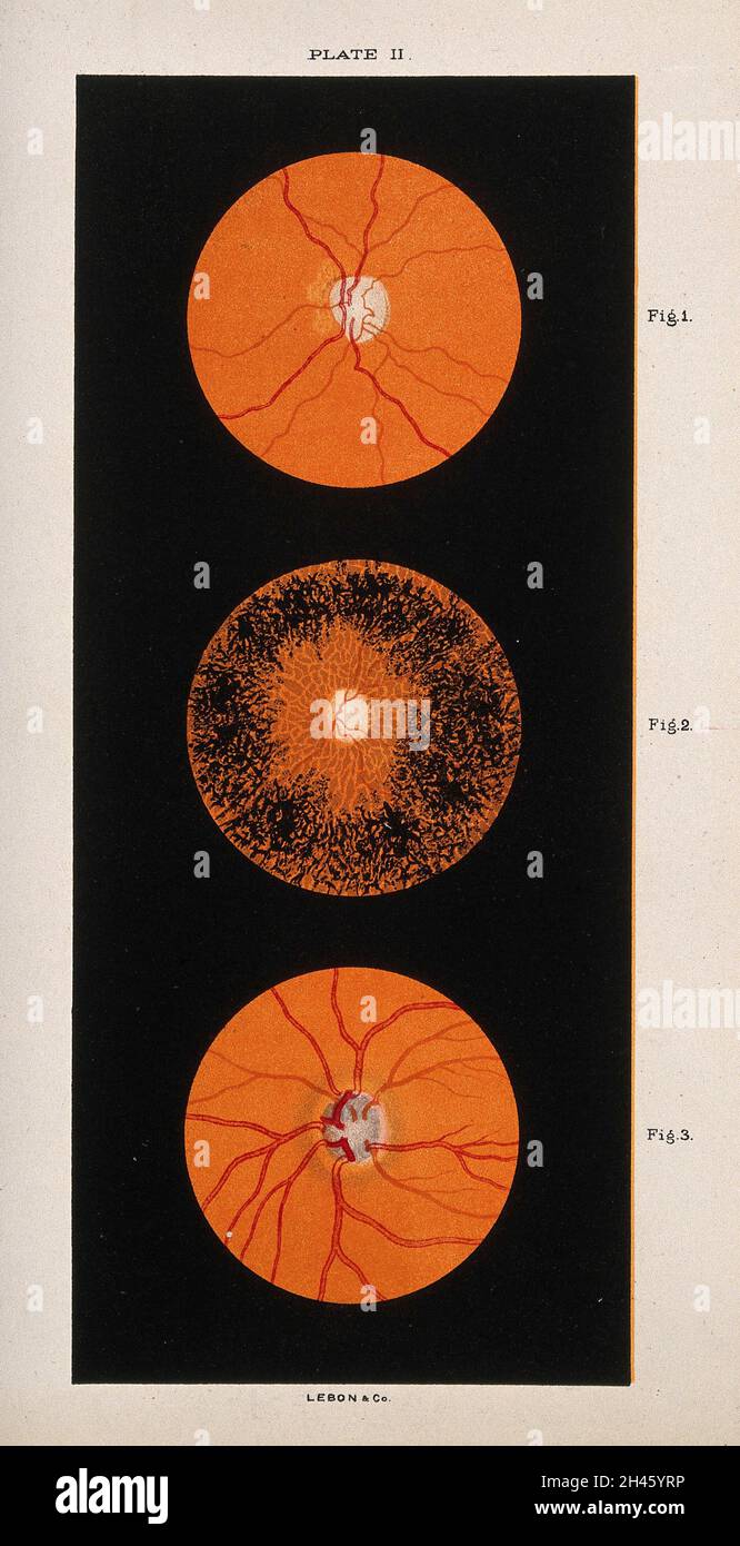 The eye, as seen through a microscope: three figures. Colour lithograph ...