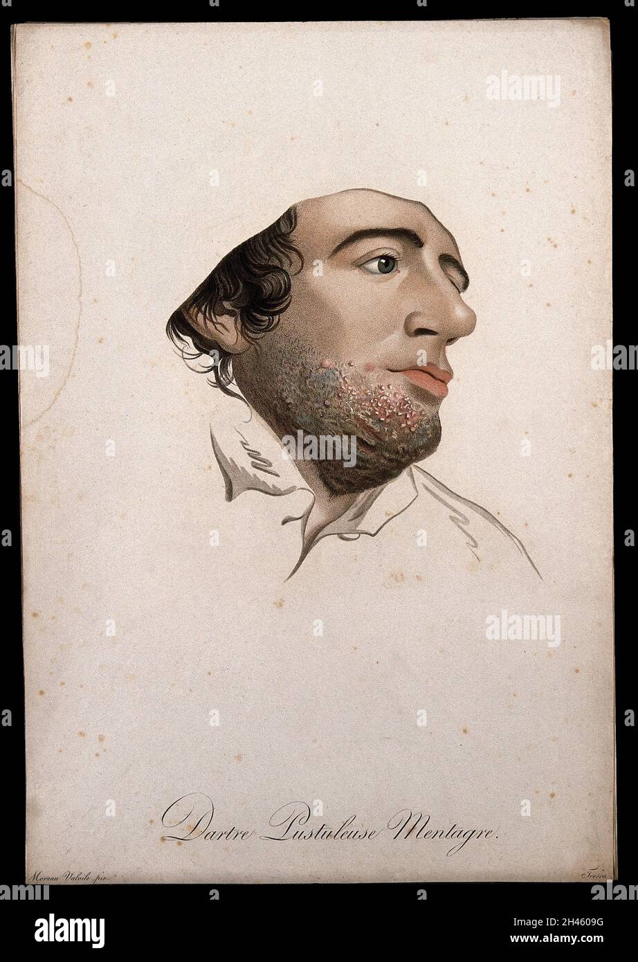 Head of a man with a skin disease on his chin. Coloured stipple ...