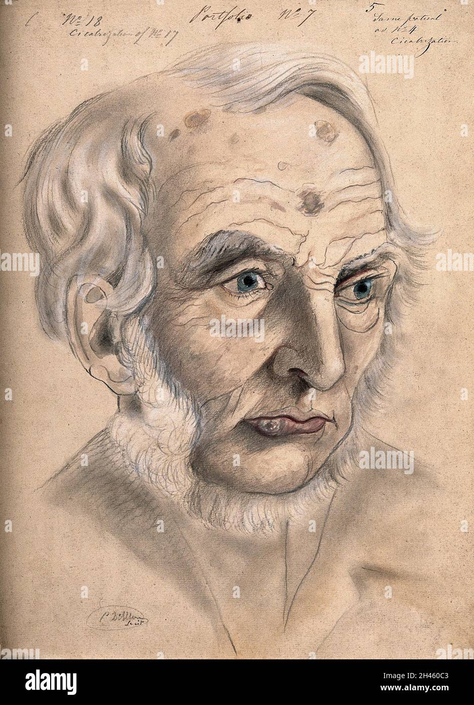 A man suffering from chancre of the lip, displaying scar tissue on his ...