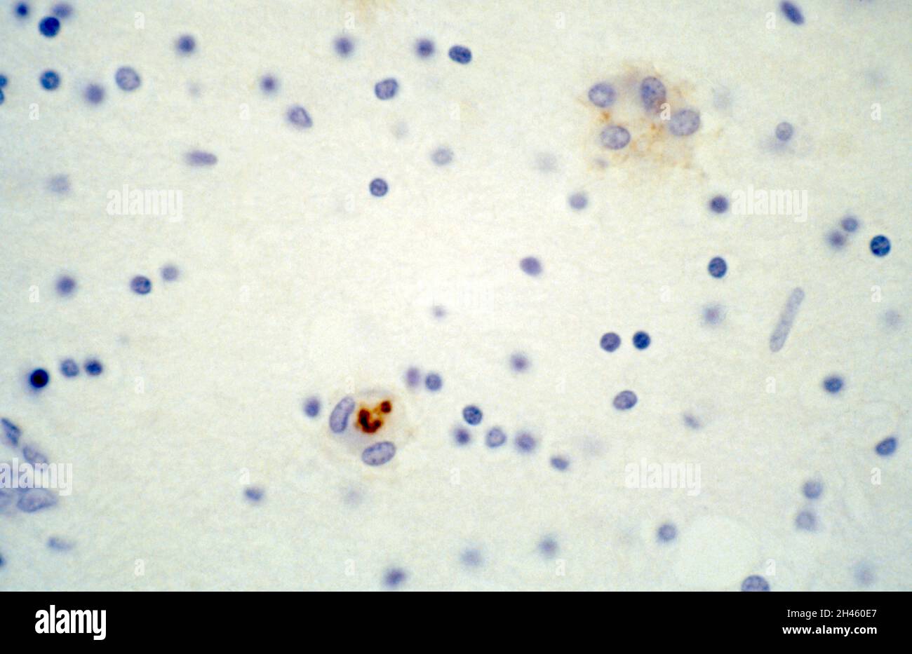 Brain: HIV encephalopathy Stock Photo - Alamy