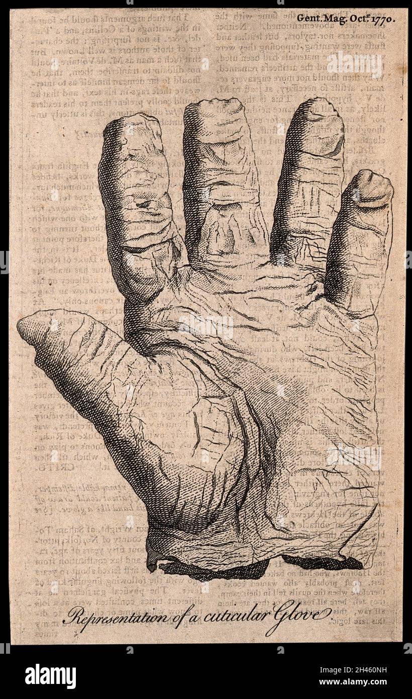 Skin of the hand peeled off like a glove as a result of a skin disease ...