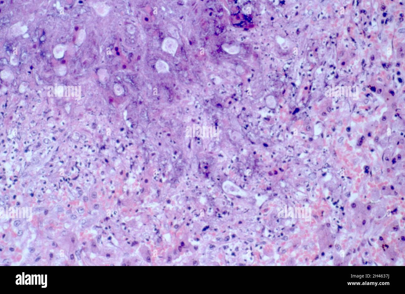 Amoebiasis: amoebic abscess in liver Stock Photo - Alamy