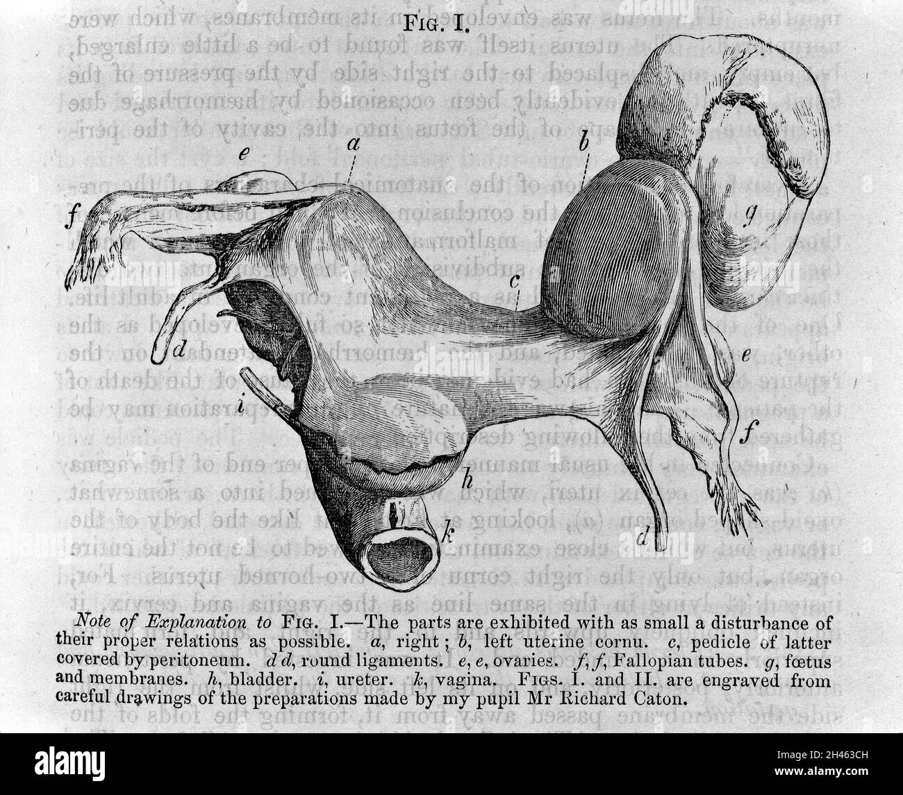 Congenital malformation hi-res stock photography and images - Alamy