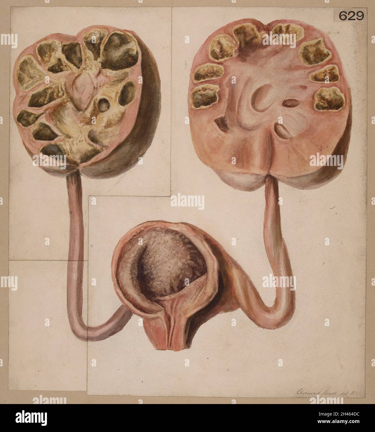Tuberculosis of the bladder hi-res stock photography and images - Alamy