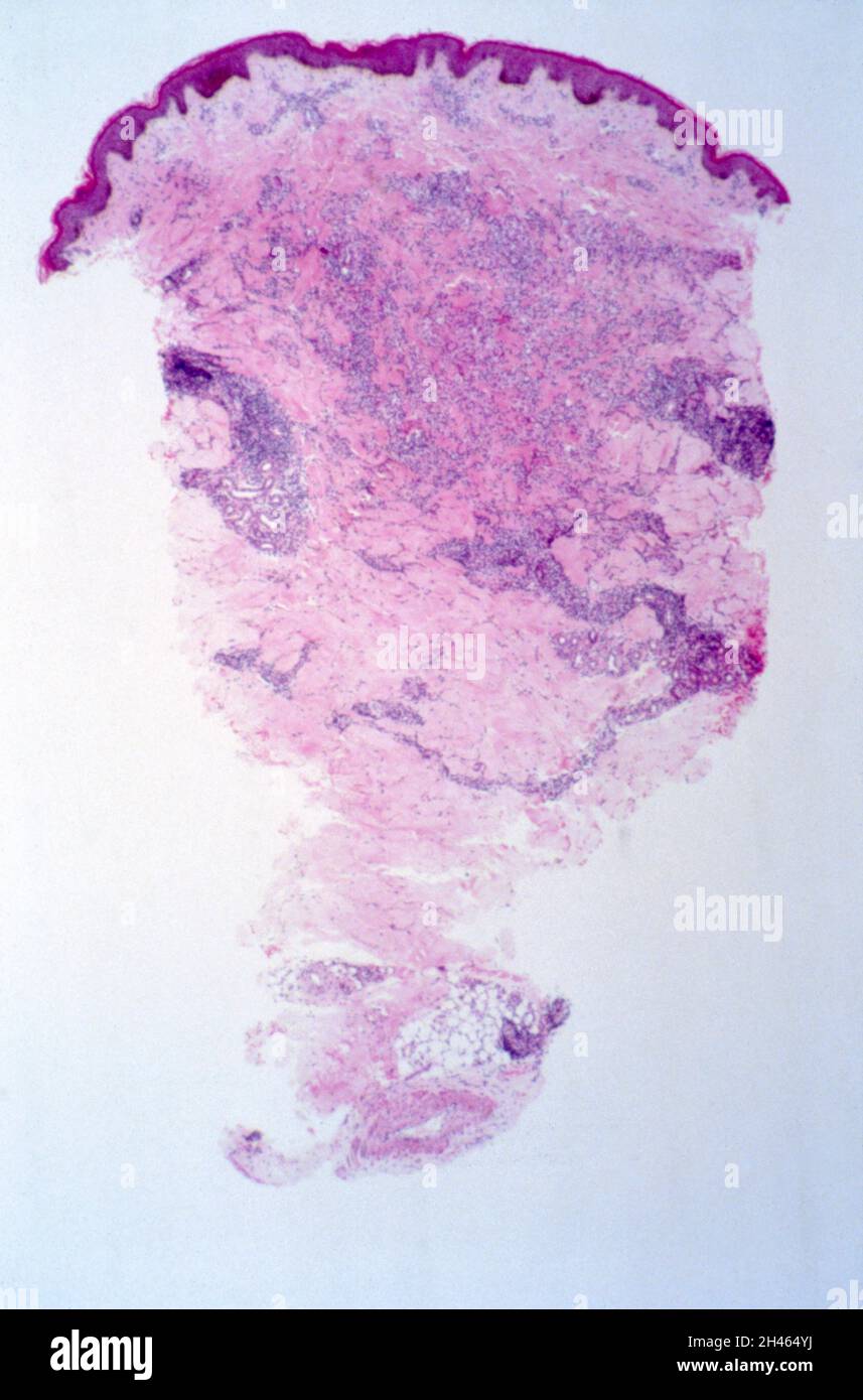 Chronic bacterial skin disease hi-res stock photography and images - Alamy