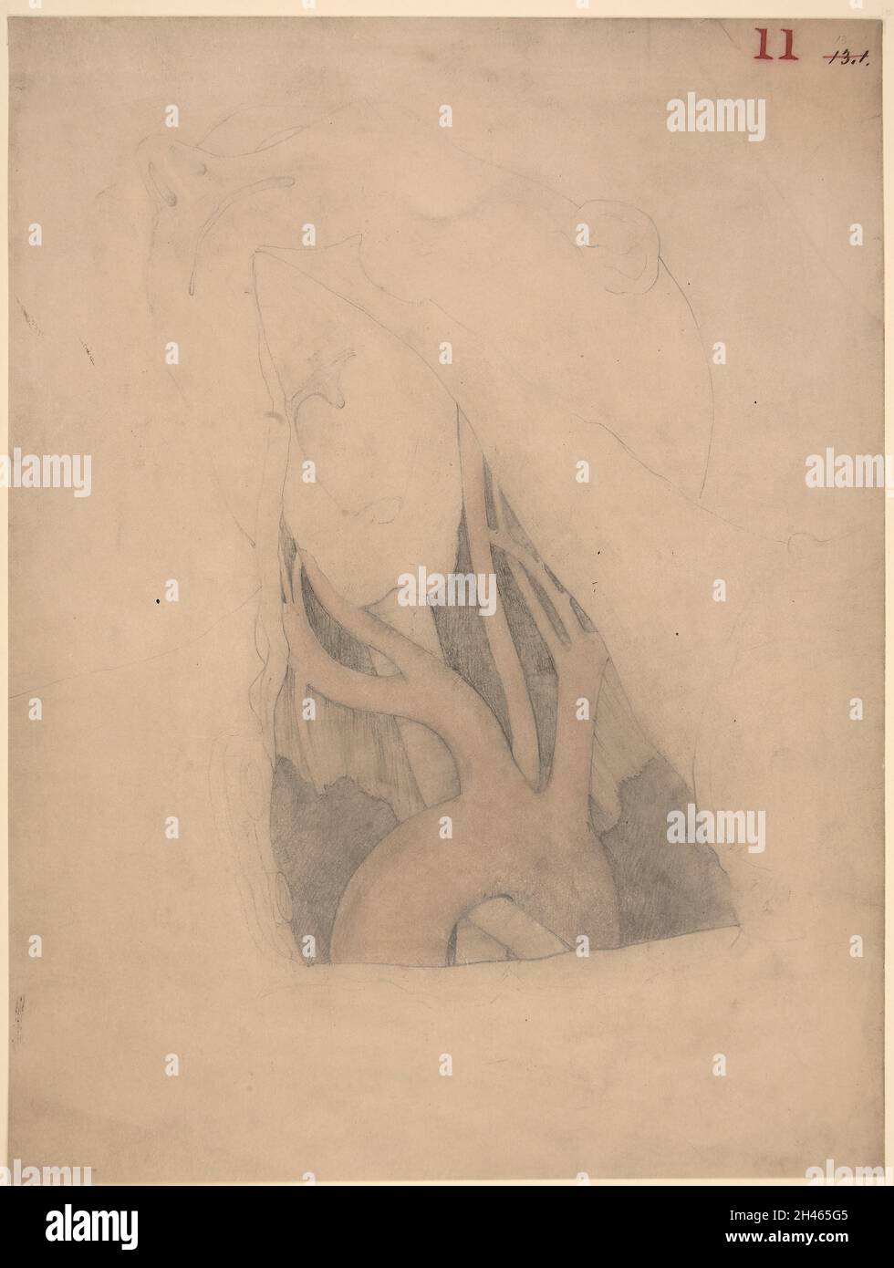 Great Vessels At The Base Of The Neck Showing An Irregular Course Of The Innominate Artery Stock