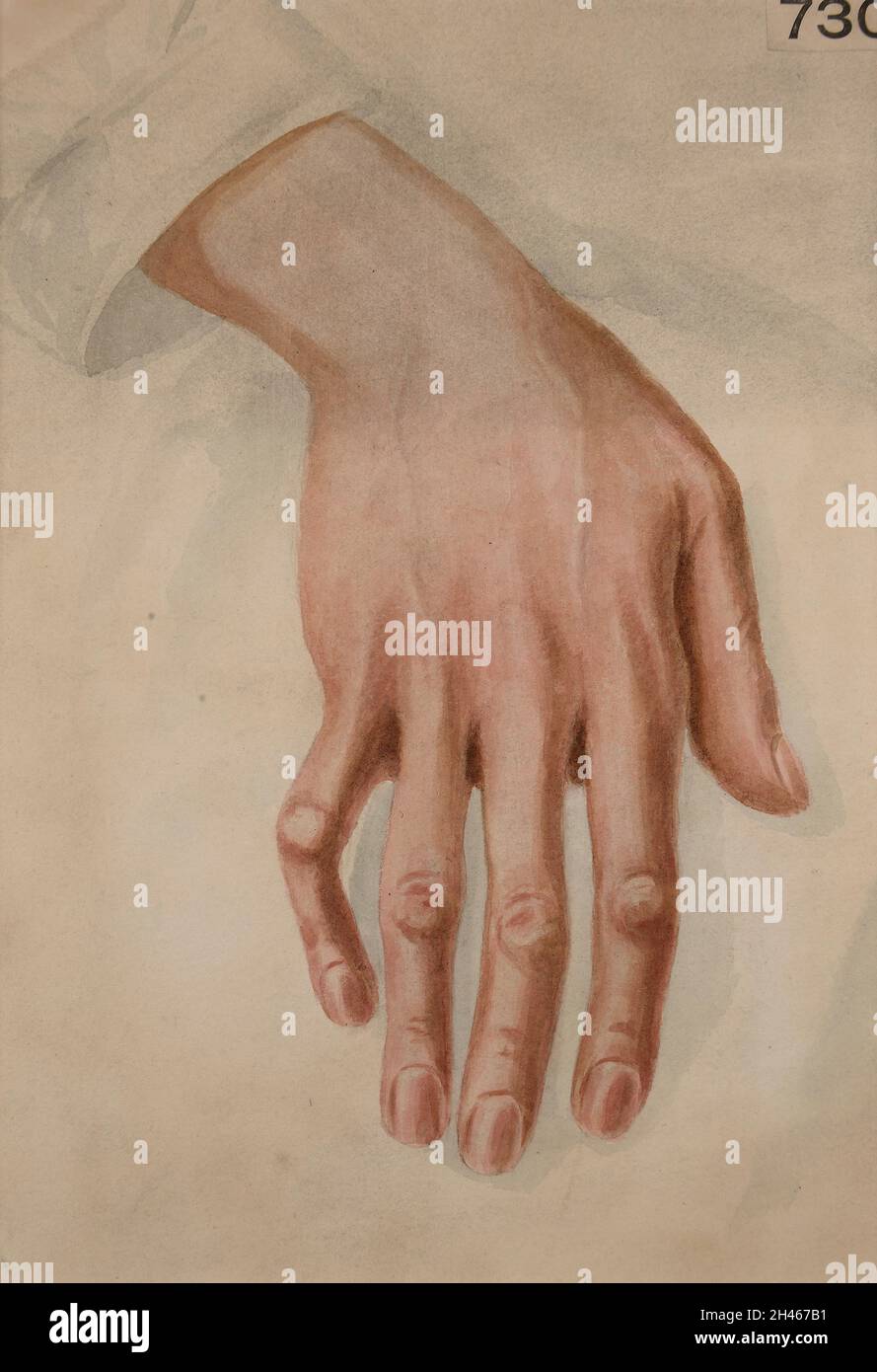 Right hand of a patient whose left median nerve was divided three years ...