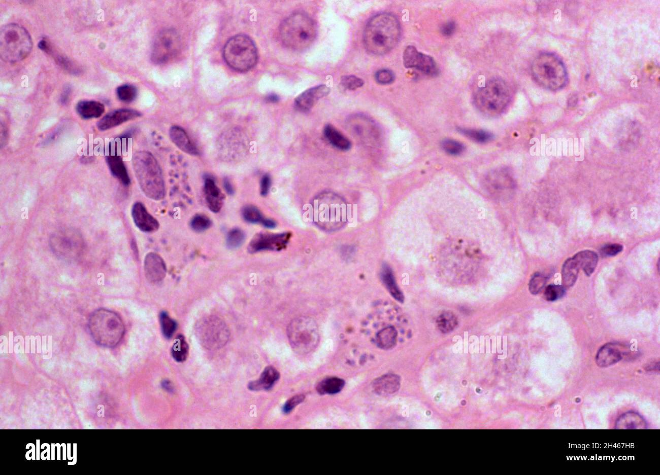 Visceral leishmaniasis): liver Stock Photo - Alamy