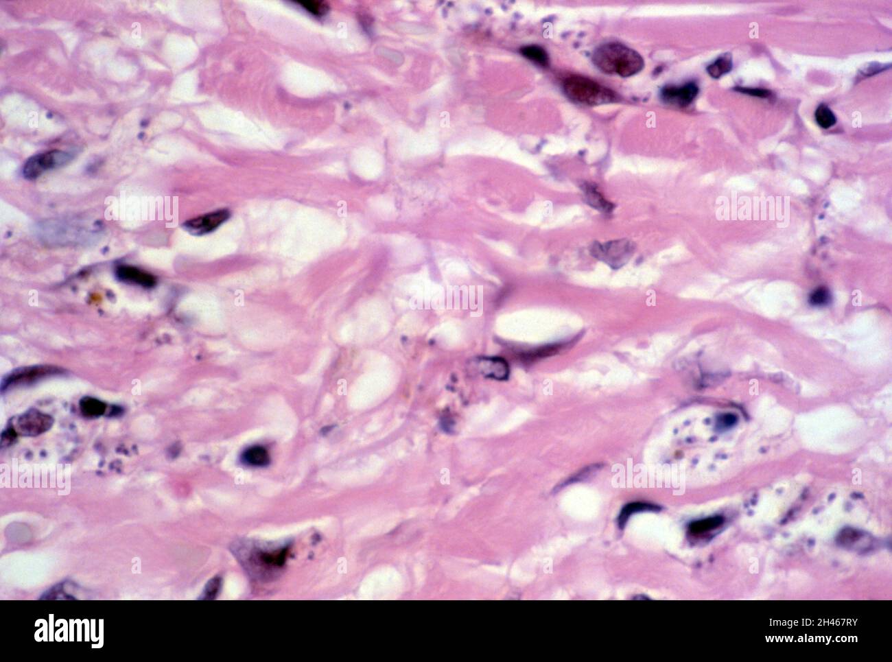 Leishmaniasis with HIV Stock Photo - Alamy