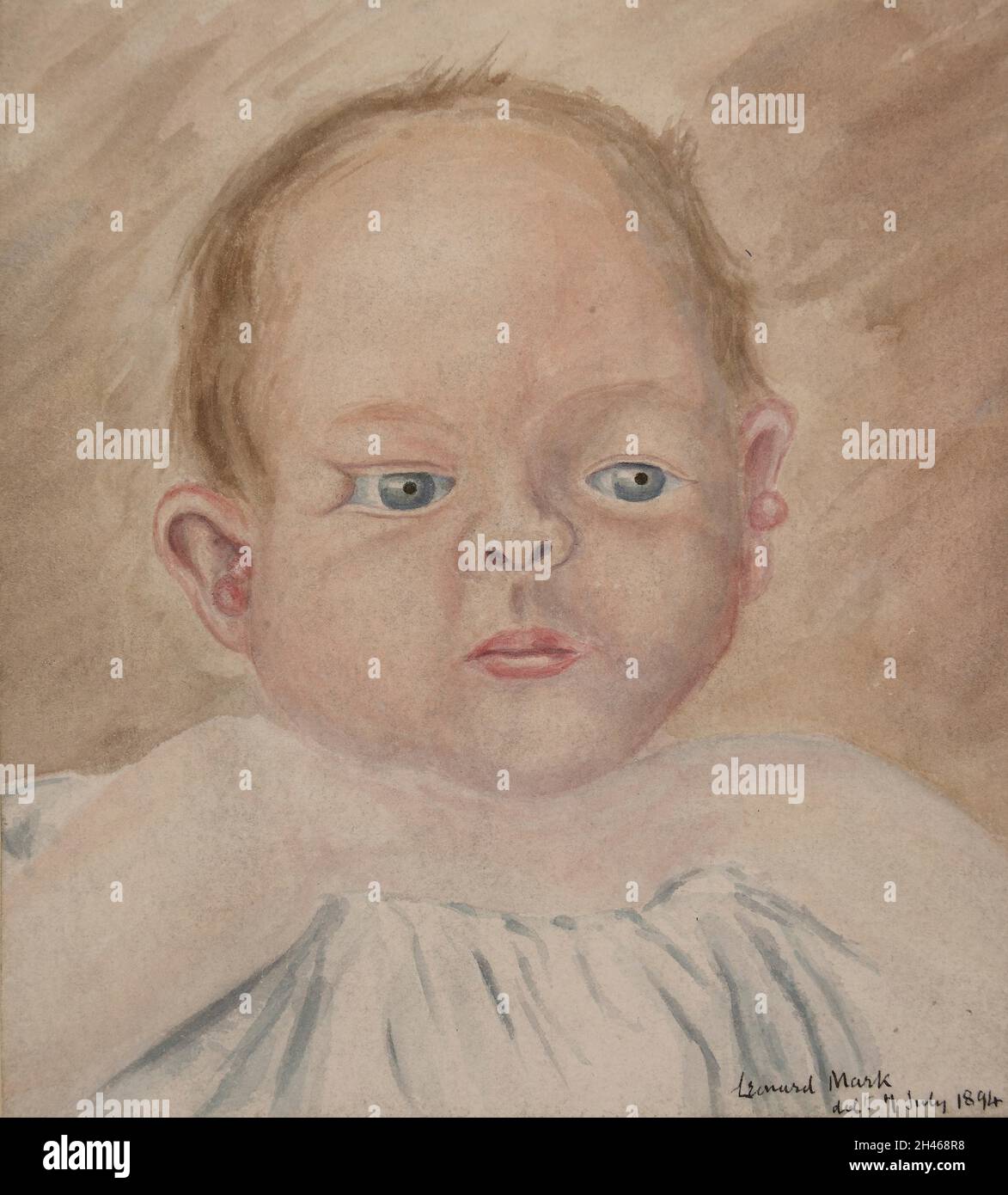 Congenital deformities hi-res stock photography and images - Alamy