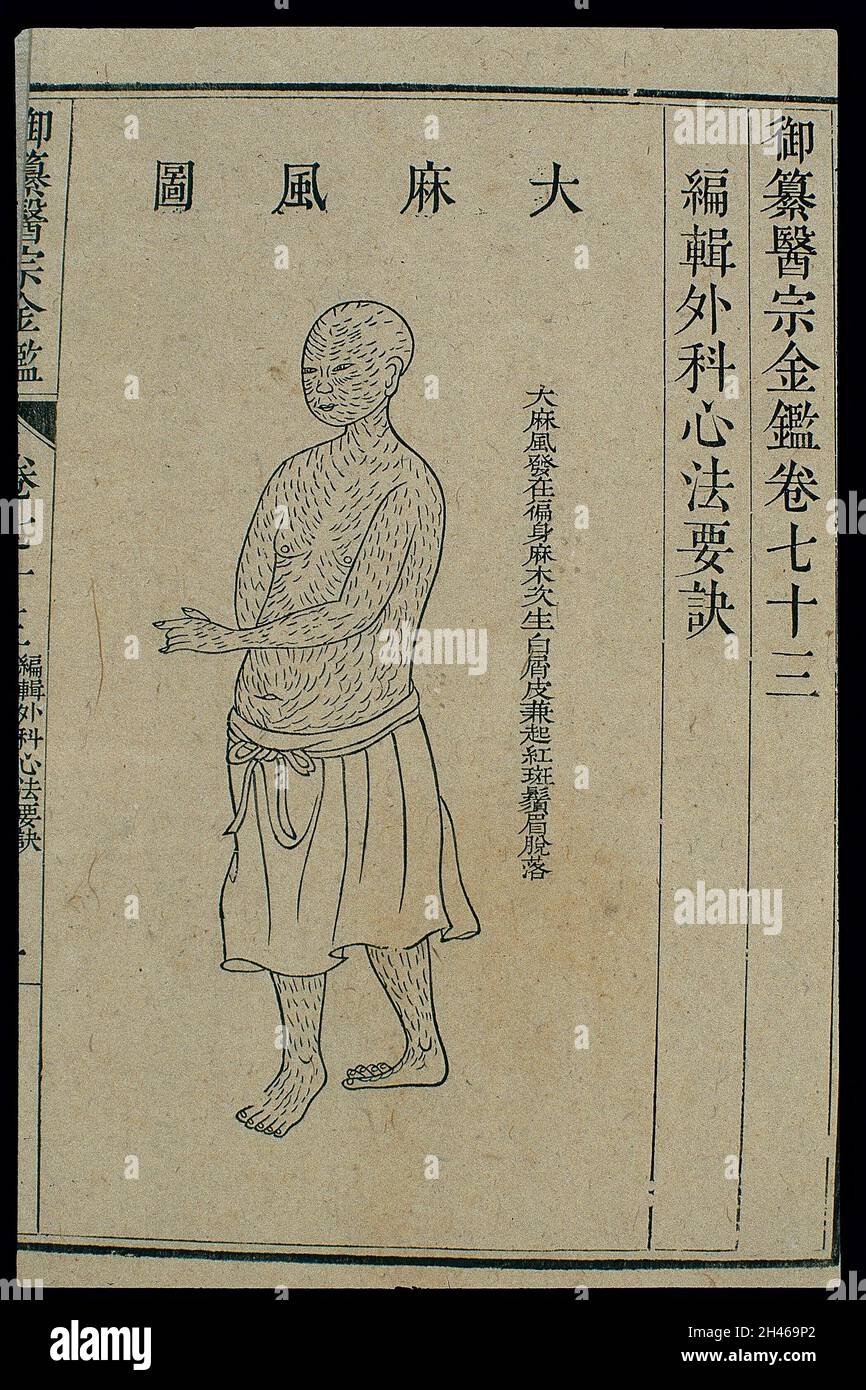 Chinese C18 woodcut: External medicine - 'Hemp wind' rash Stock Photo ...