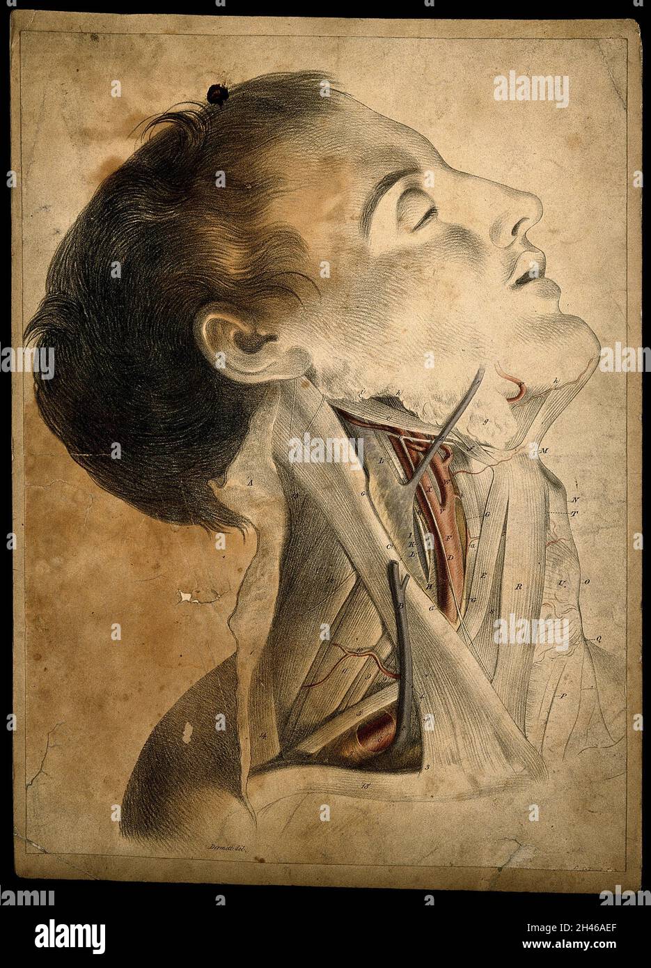 Neck dissection hi-res stock photography and images - Alamy