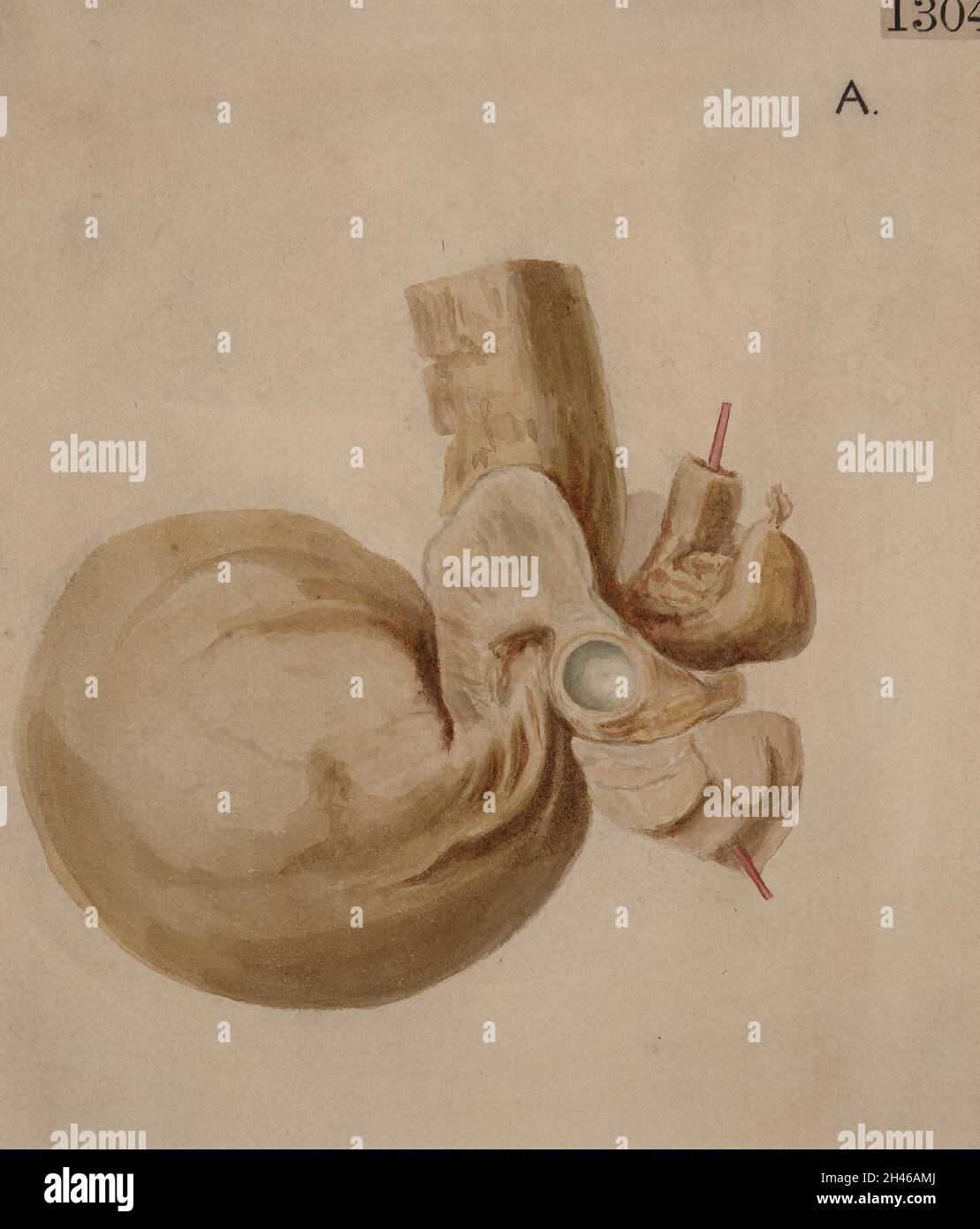 Congenital cyst which grew from the region of the coccyx, exterior ...