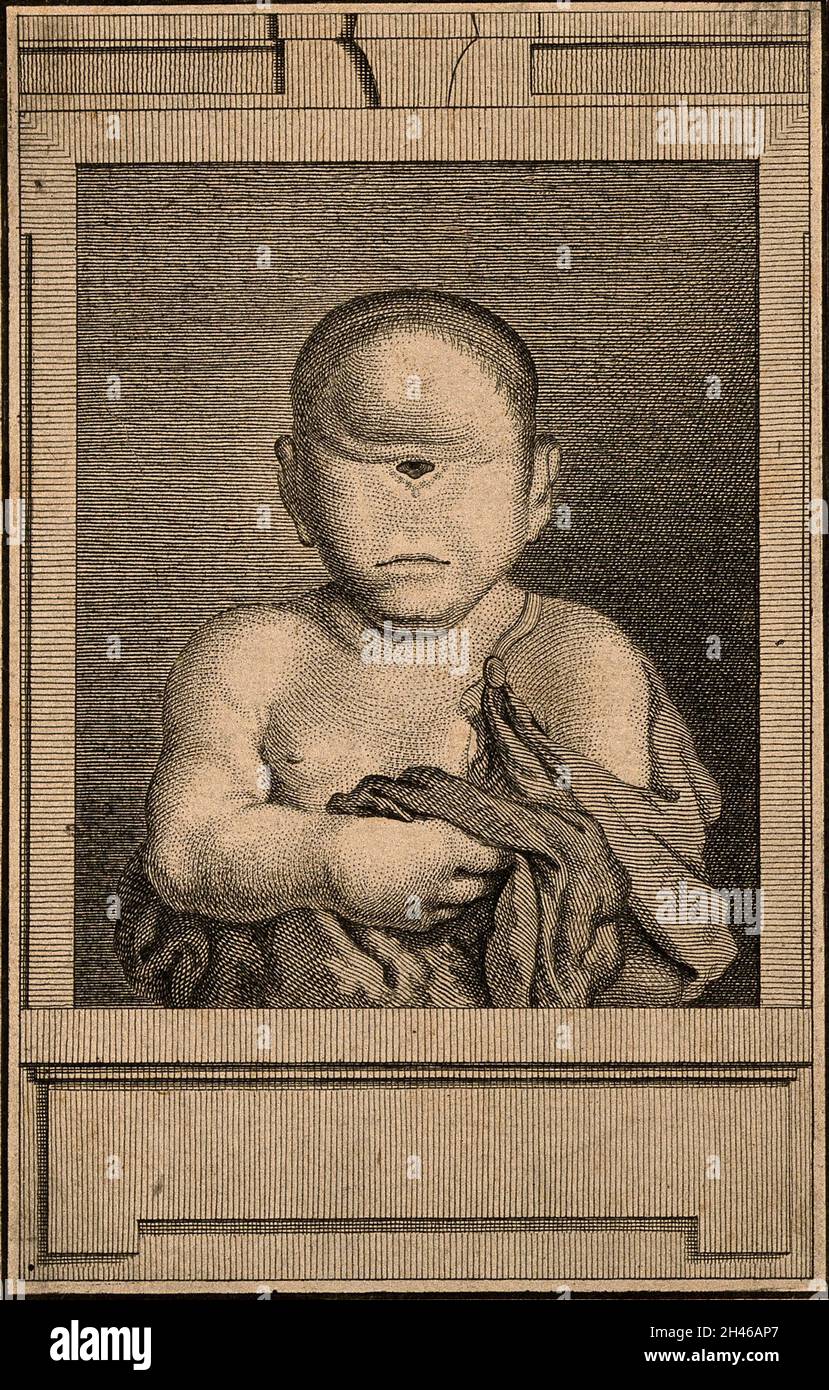 Birth defect eye hi-res stock photography and images - Alamy