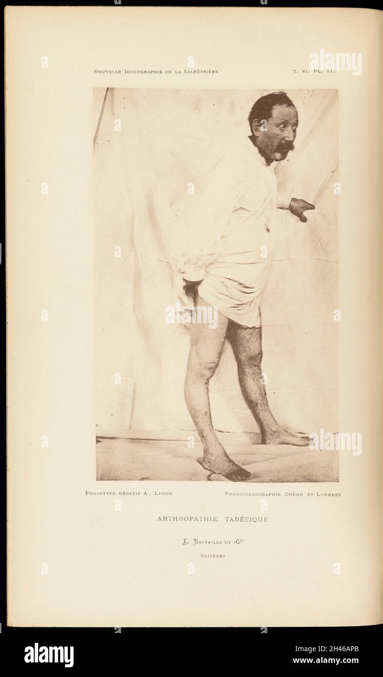 Male figure with tabetic arthropathy Stock Photo - Alamy