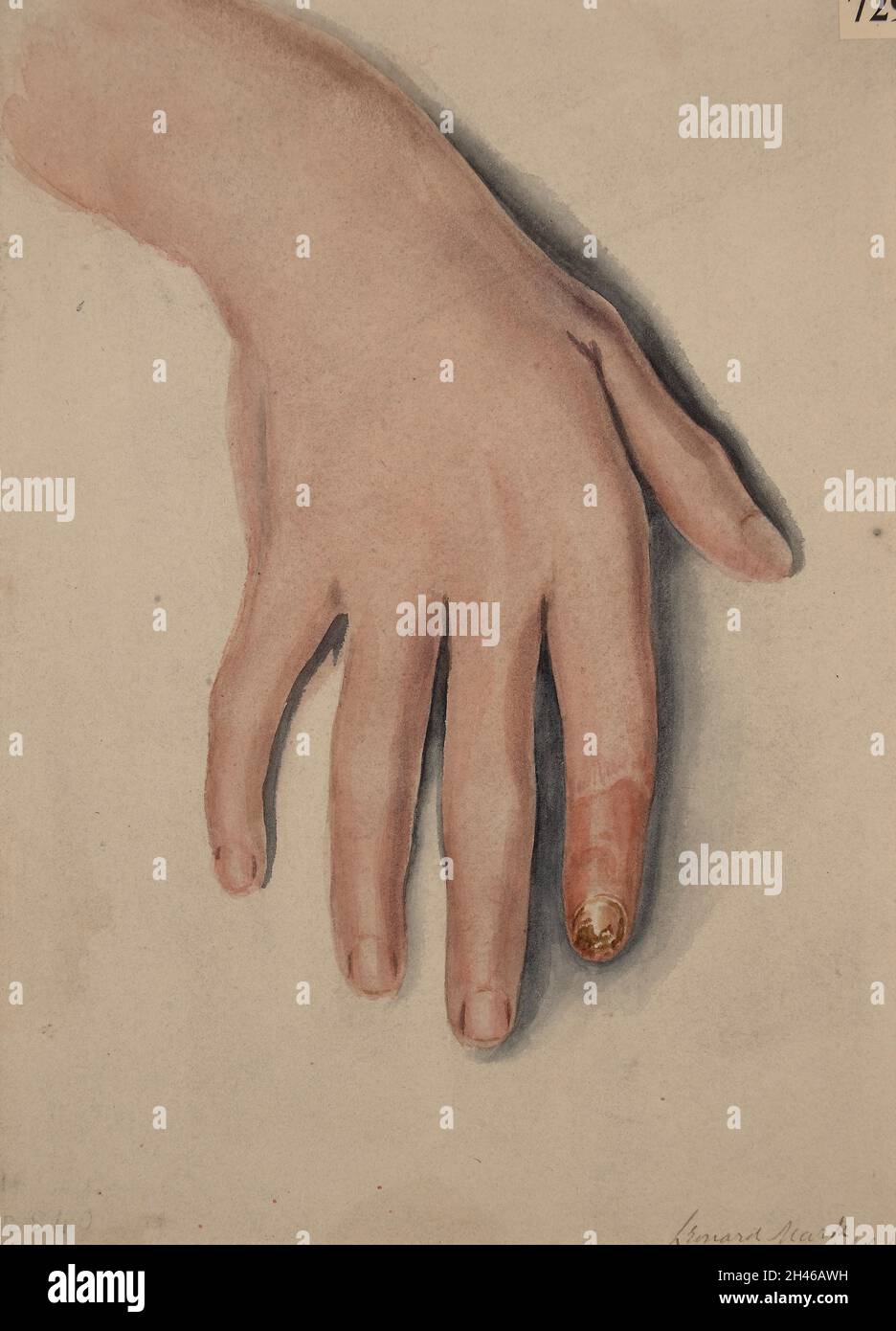 Changes in the index finger of the left hand after section of the ...