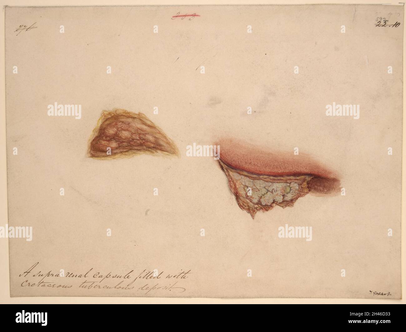 Tubercular hi-res stock photography and images - Alamy