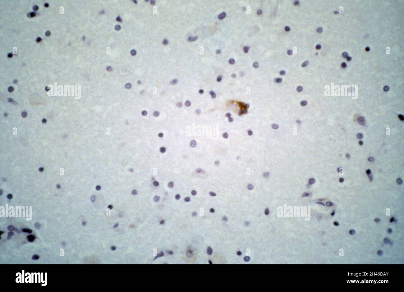 Brain: HIV encephalopathy Stock Photo - Alamy