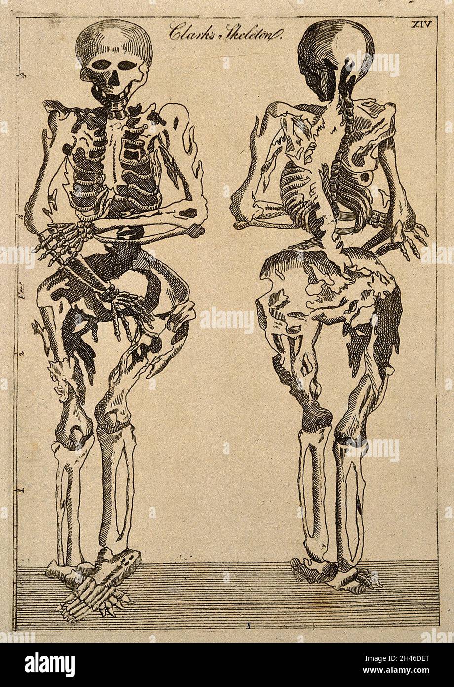 Deformed human skeleton, front and back views. Line engraving ca. 1808 ...