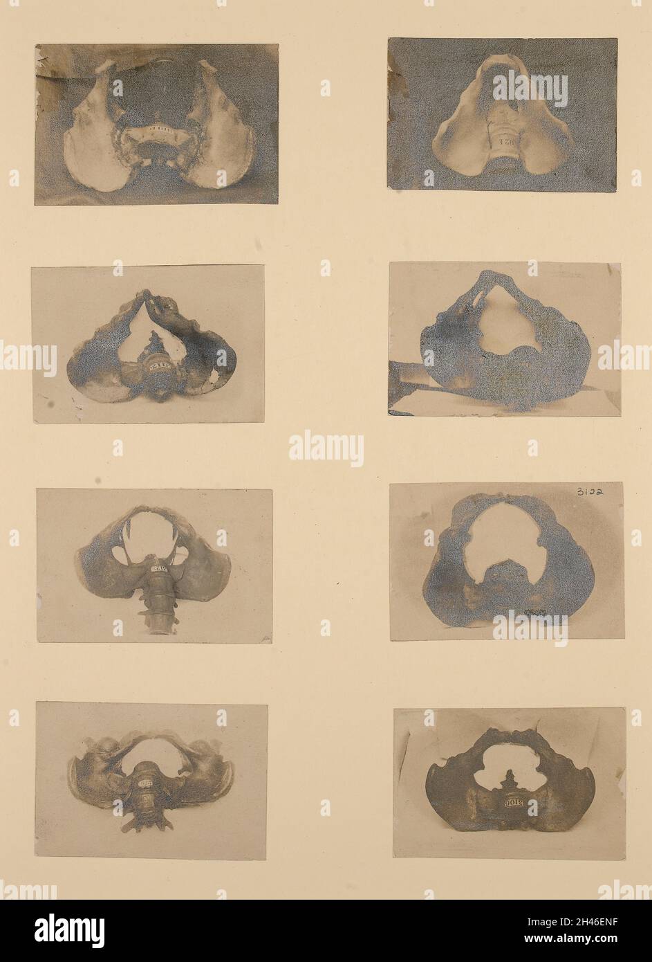 Eight photographs of pelves once held in the St Bartholomew's Hospital ...