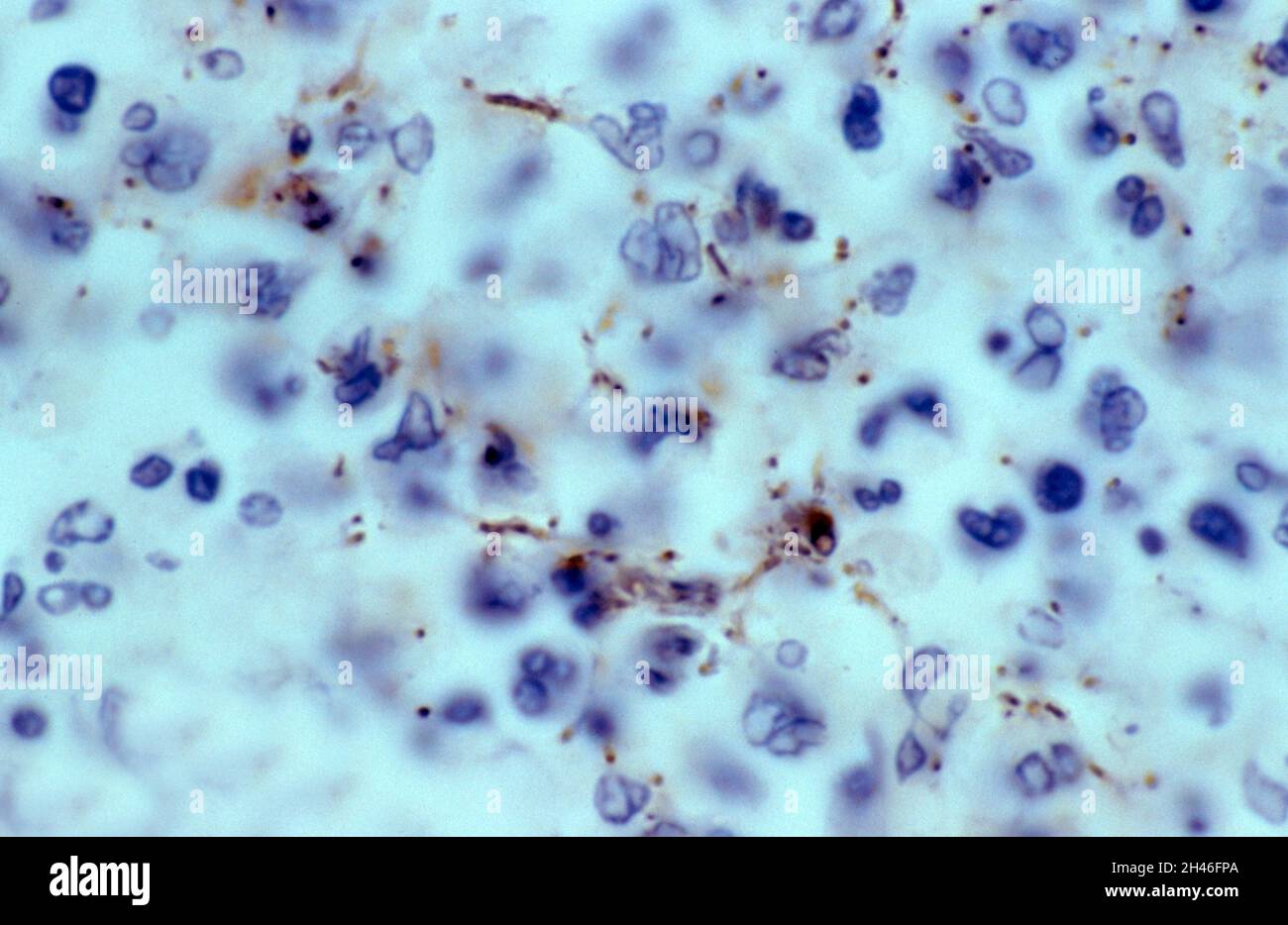 Lung: nocardiosis with HIV Stock Photo - Alamy