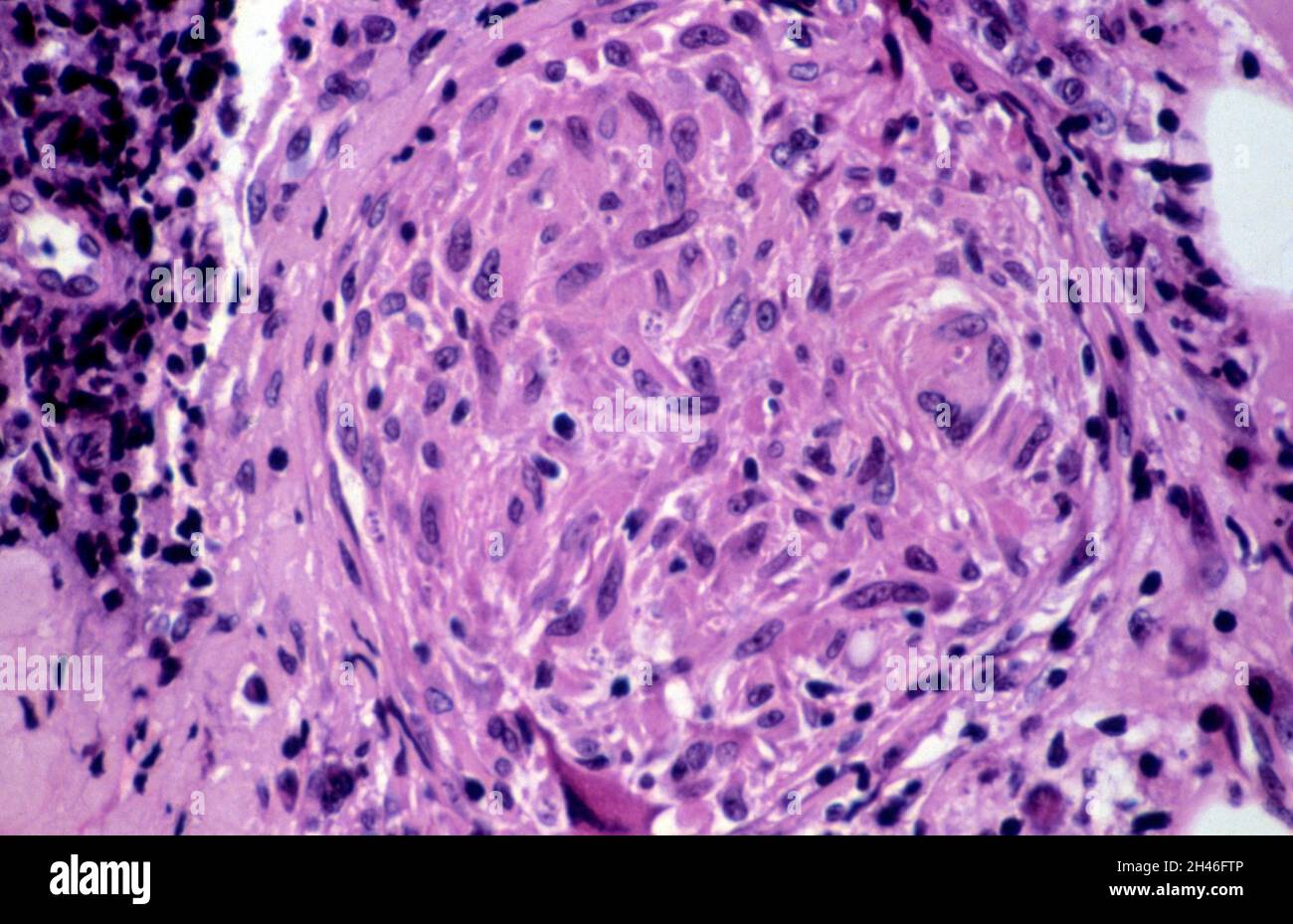 Cutaneous leishmaniasis: skin lesion Stock Photo - Alamy