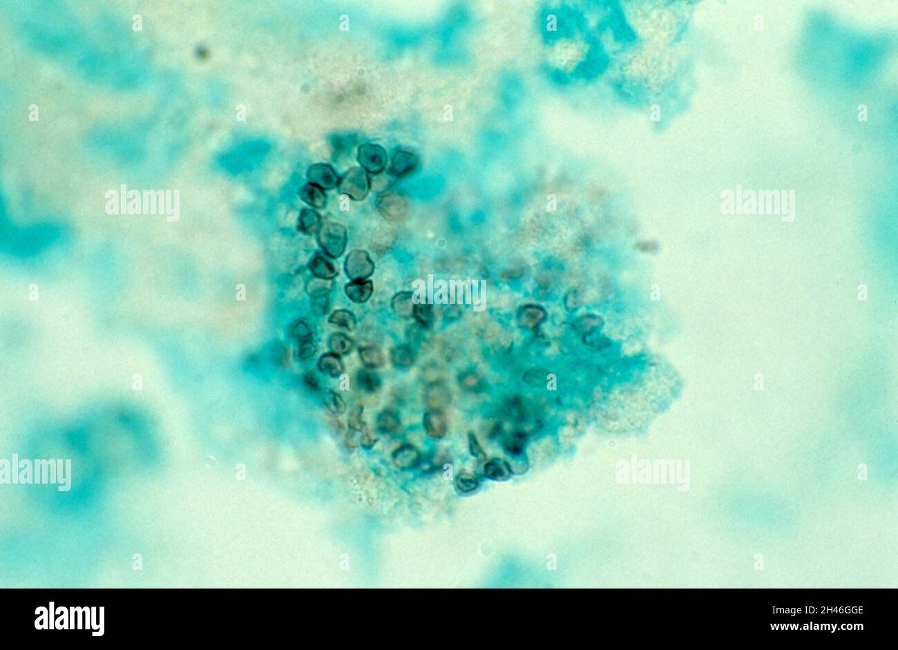 Lung: Pneumocystis carinii pneumonia (PCP) with HIV Stock Photo - Alamy