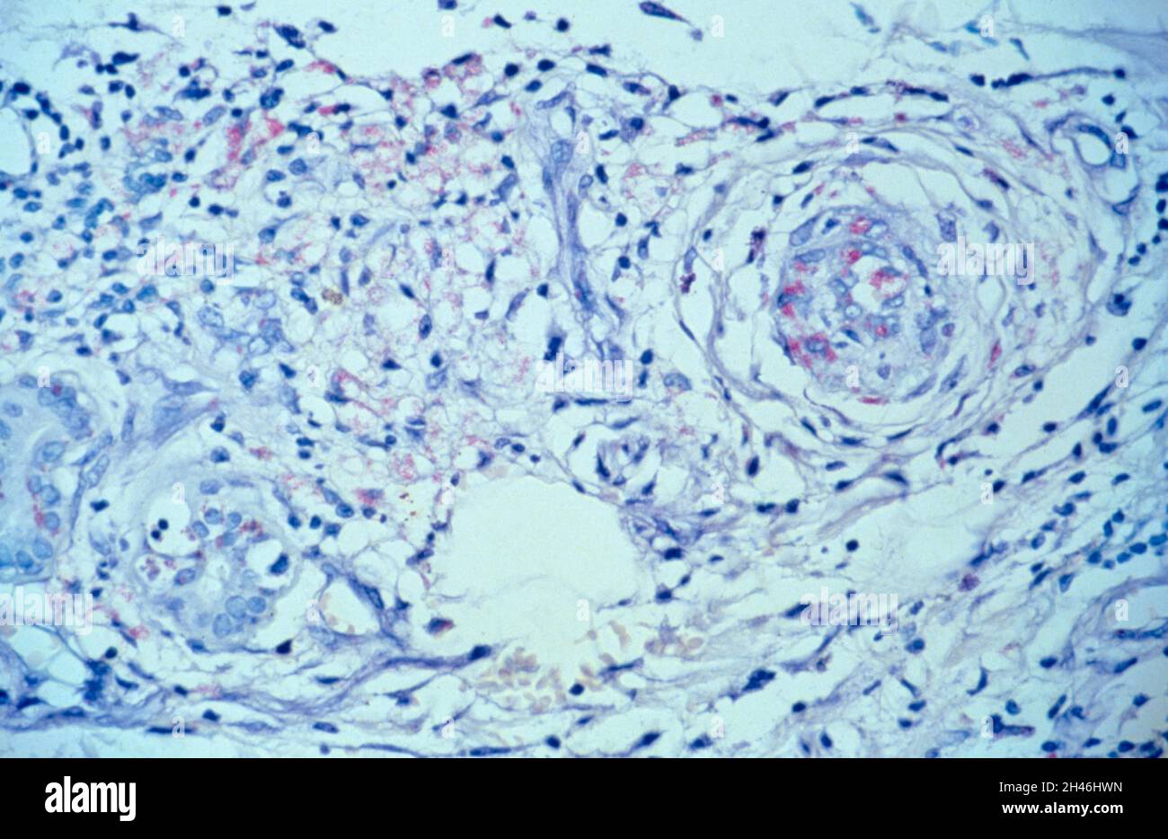 Diffuse lepromatous leprosy: Lucio phenomenon Stock Photo - Alamy