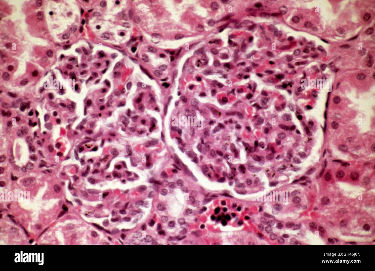Plasmodium falciparum malaria: kidney Stock Photo - Alamy