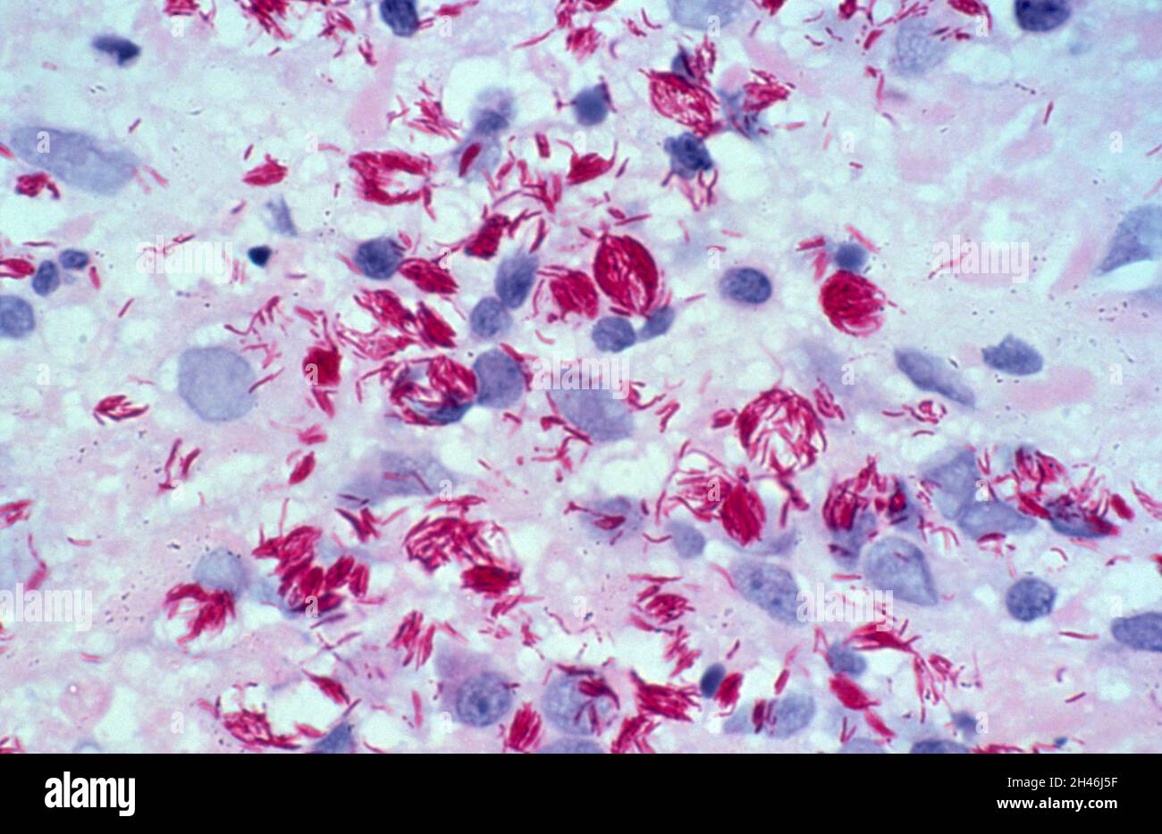 Lepromatous leprosy: local (acute) exacerbation reaction Stock Photo ...