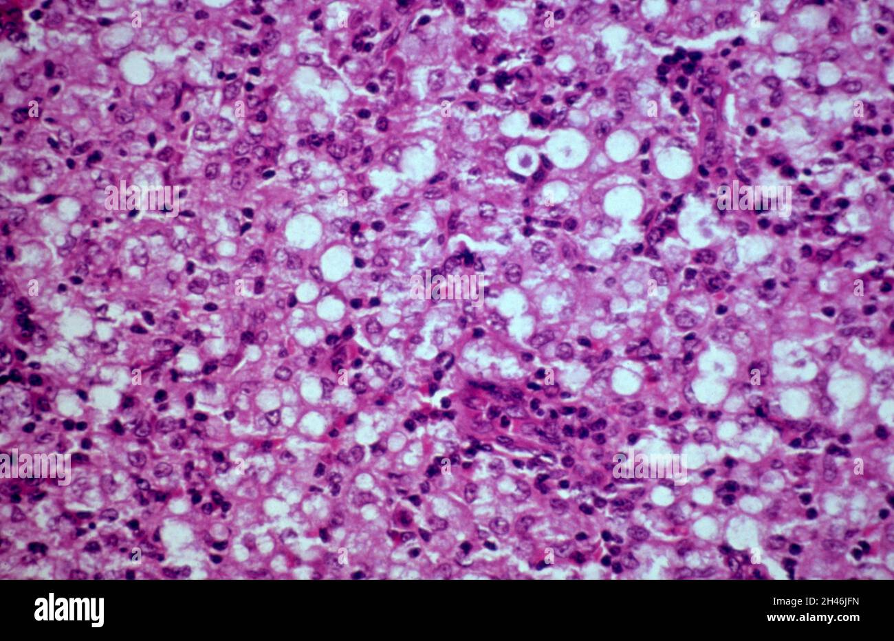 Lepromatous leprosy: lymph node Stock Photo - Alamy