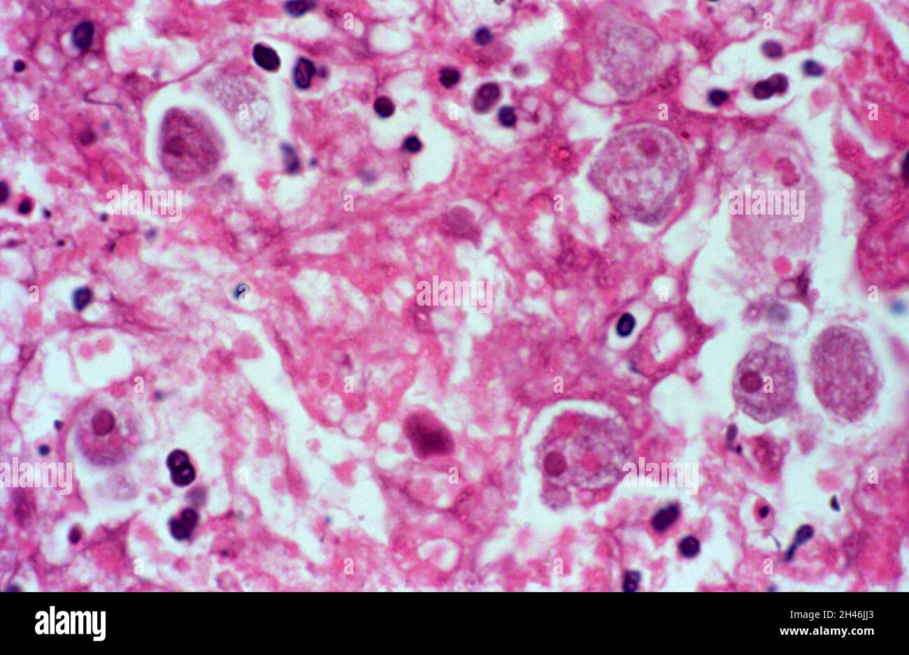 Skin: cutaneous amoebiasis Stock Photo - Alamy