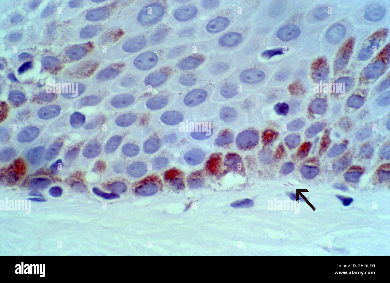 Leprosy: acid-fast bacilli Stock Photo - Alamy