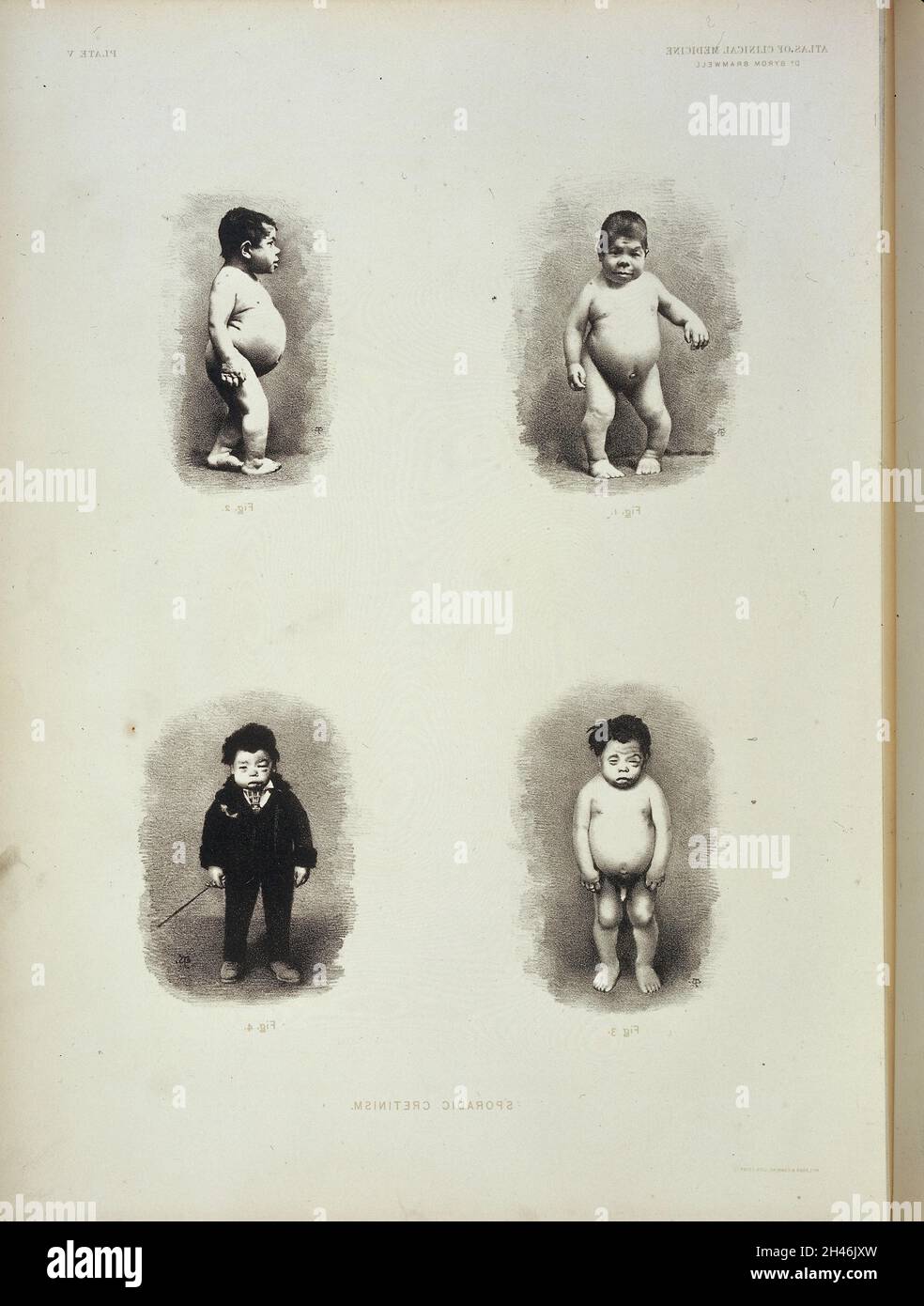 Cretinism hi-res stock photography and images - Alamy