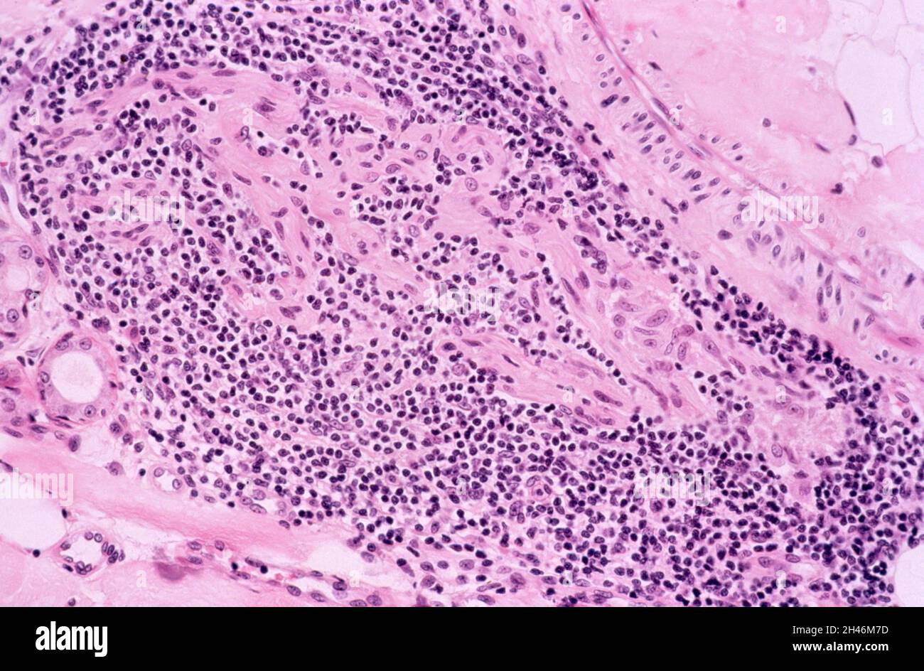 Dermal infection hi-res stock photography and images - Alamy