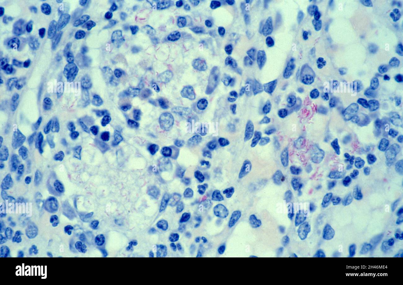 Lepromatous leprosy: spleen Stock Photo - Alamy